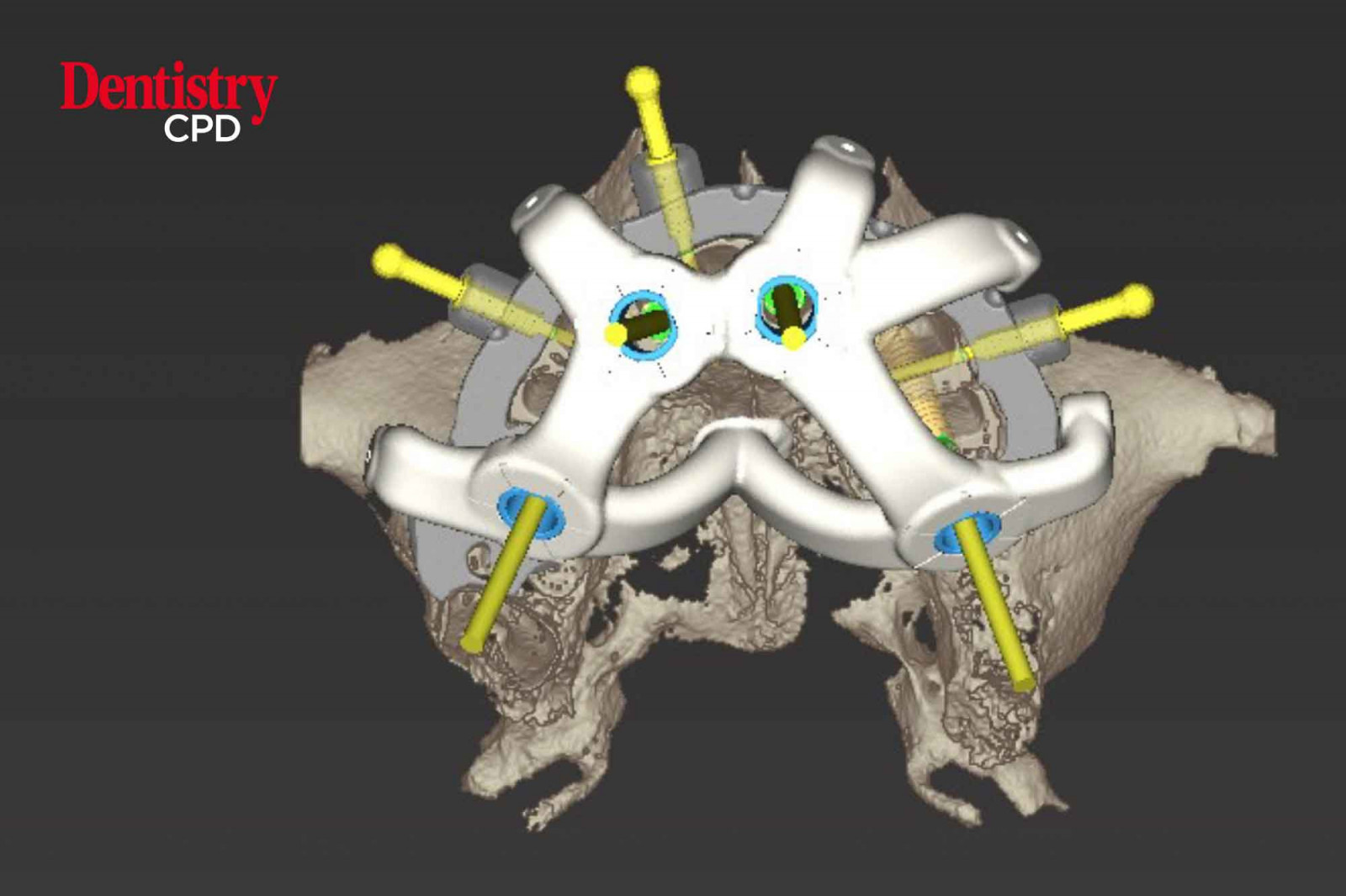 Dentistry CPD - Guided full-arch implant surgery using a chrome cobalt ...