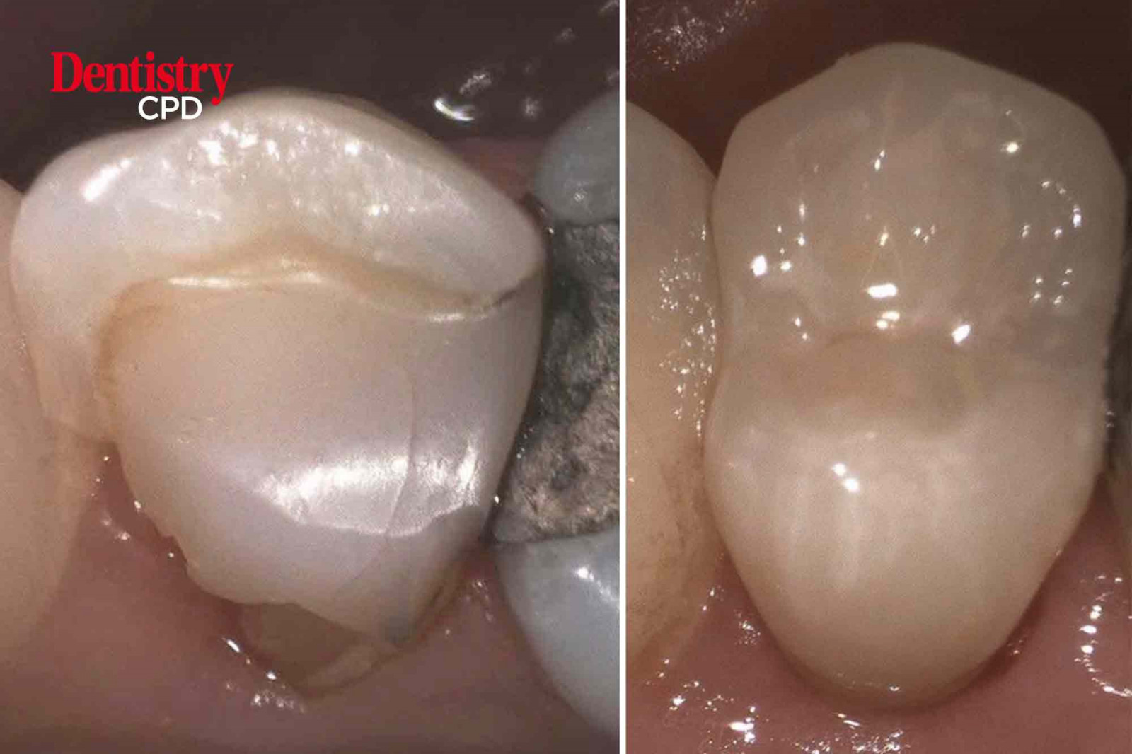 Dentistry CPD - Saving Compromised Teeth: Single visit crown ...