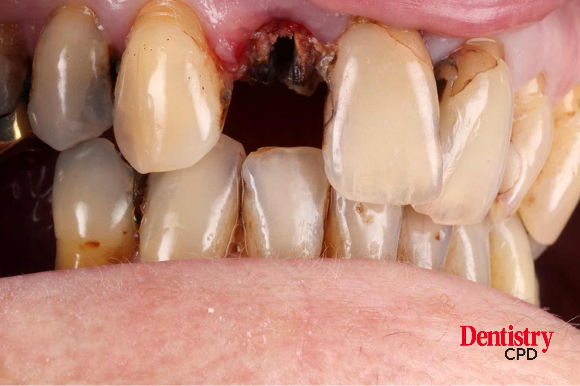 Dentistry CPD - Immediate resin-bonded bridges