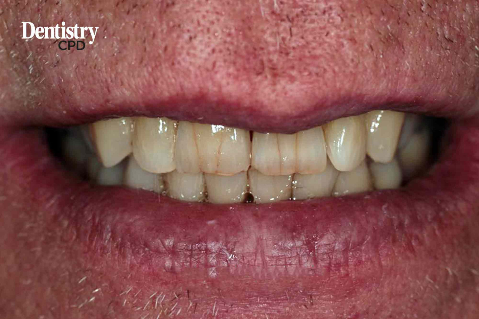 Dentistry CPD - Mimicking natural teeth