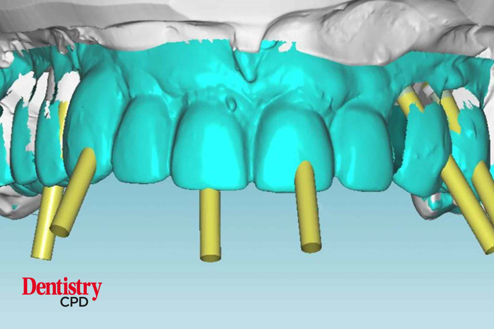 Dentistry CPD - Implant-retained prostheses using angled screws