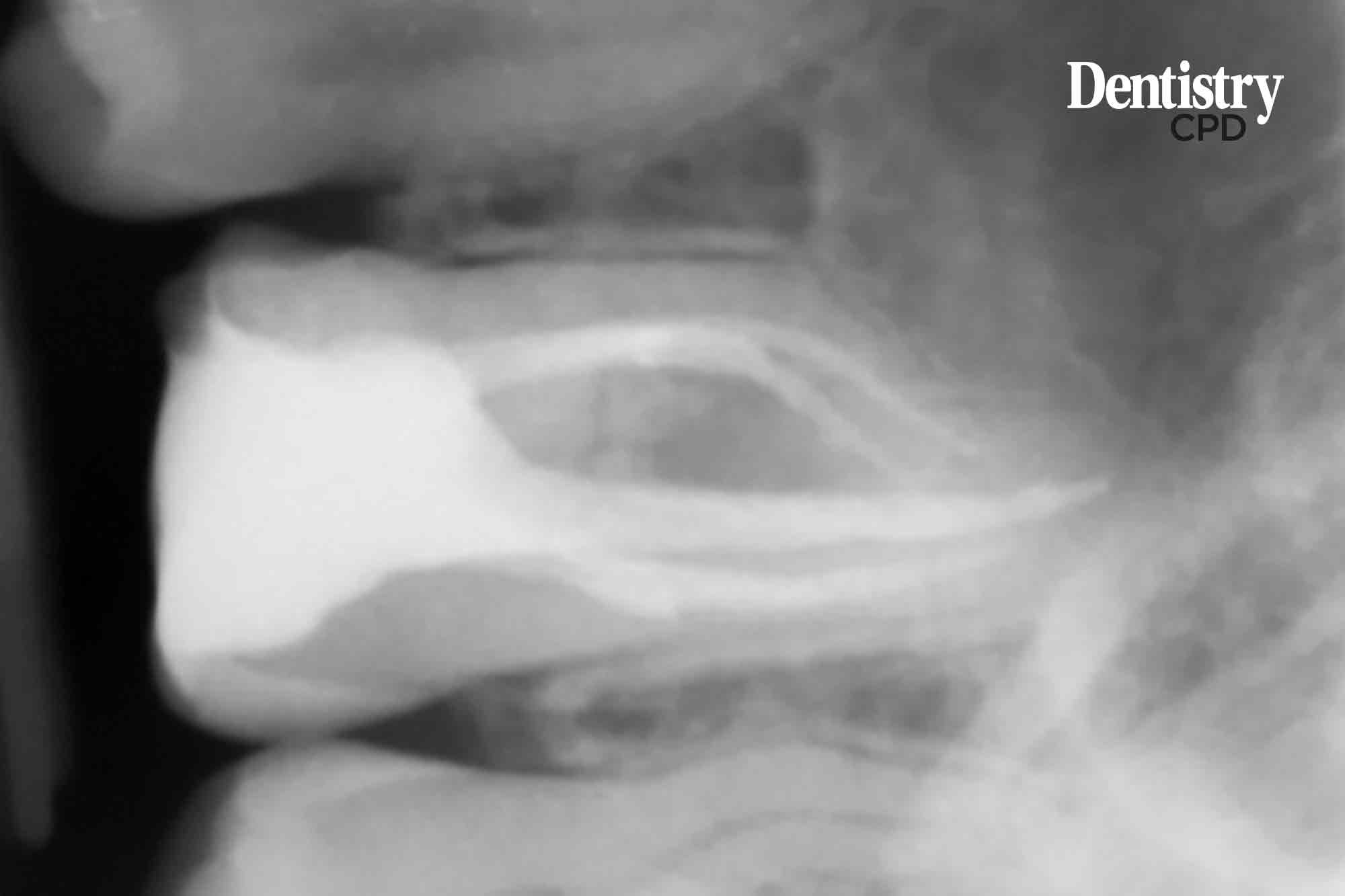 Dentistry CPD - Locating and treating the MB2