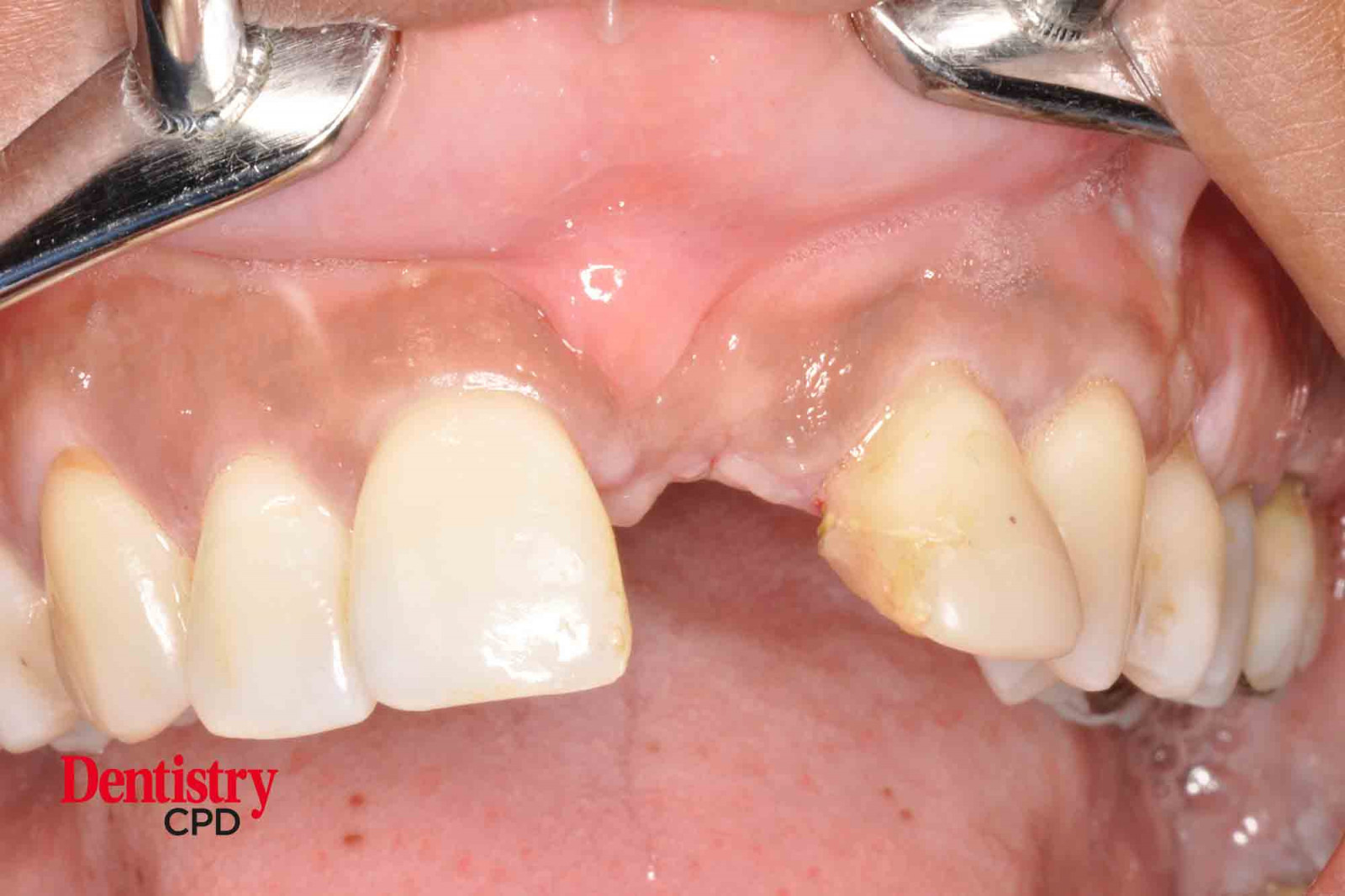 Dentistry CPD - Vertical ridge augmentation: techniques and case study
