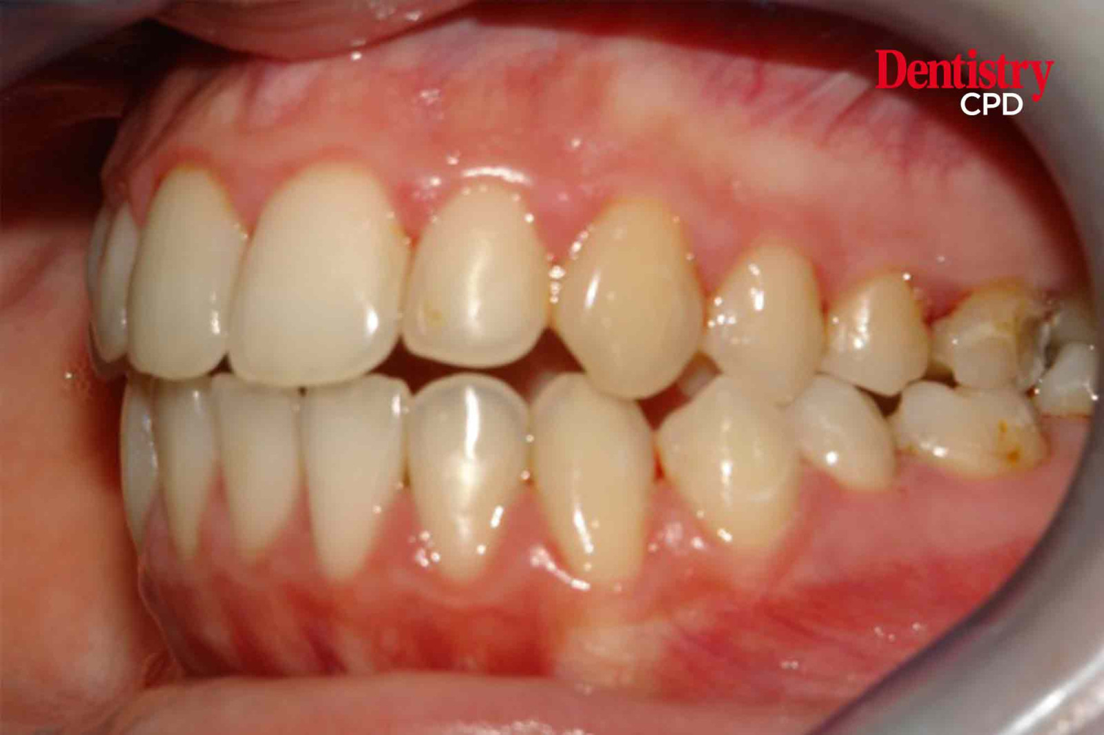 Dentistry CPD - Molar distalization with Invisalign in an adult patient ...