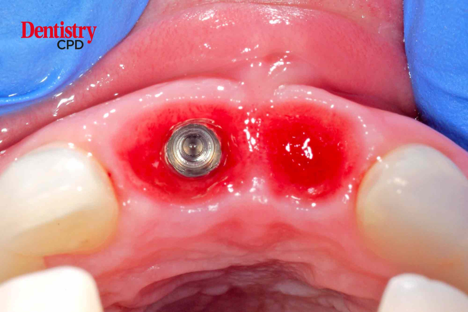 Dentistry CPD - Dual zone grafting