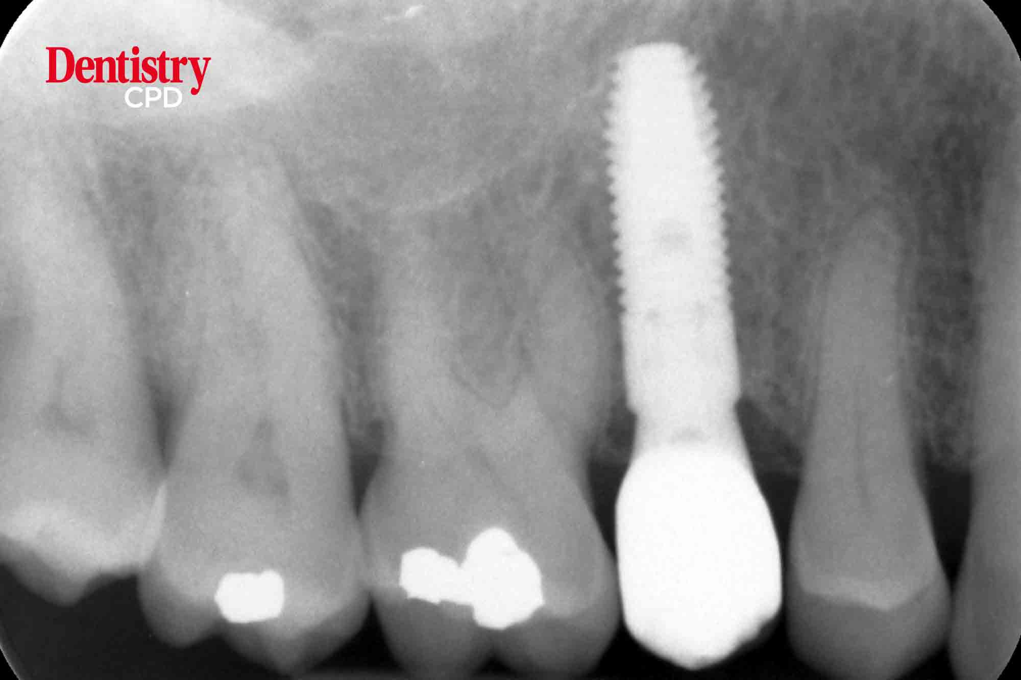 Dentistry CPD - Screw-retained, digitally designed implant-supported ...
