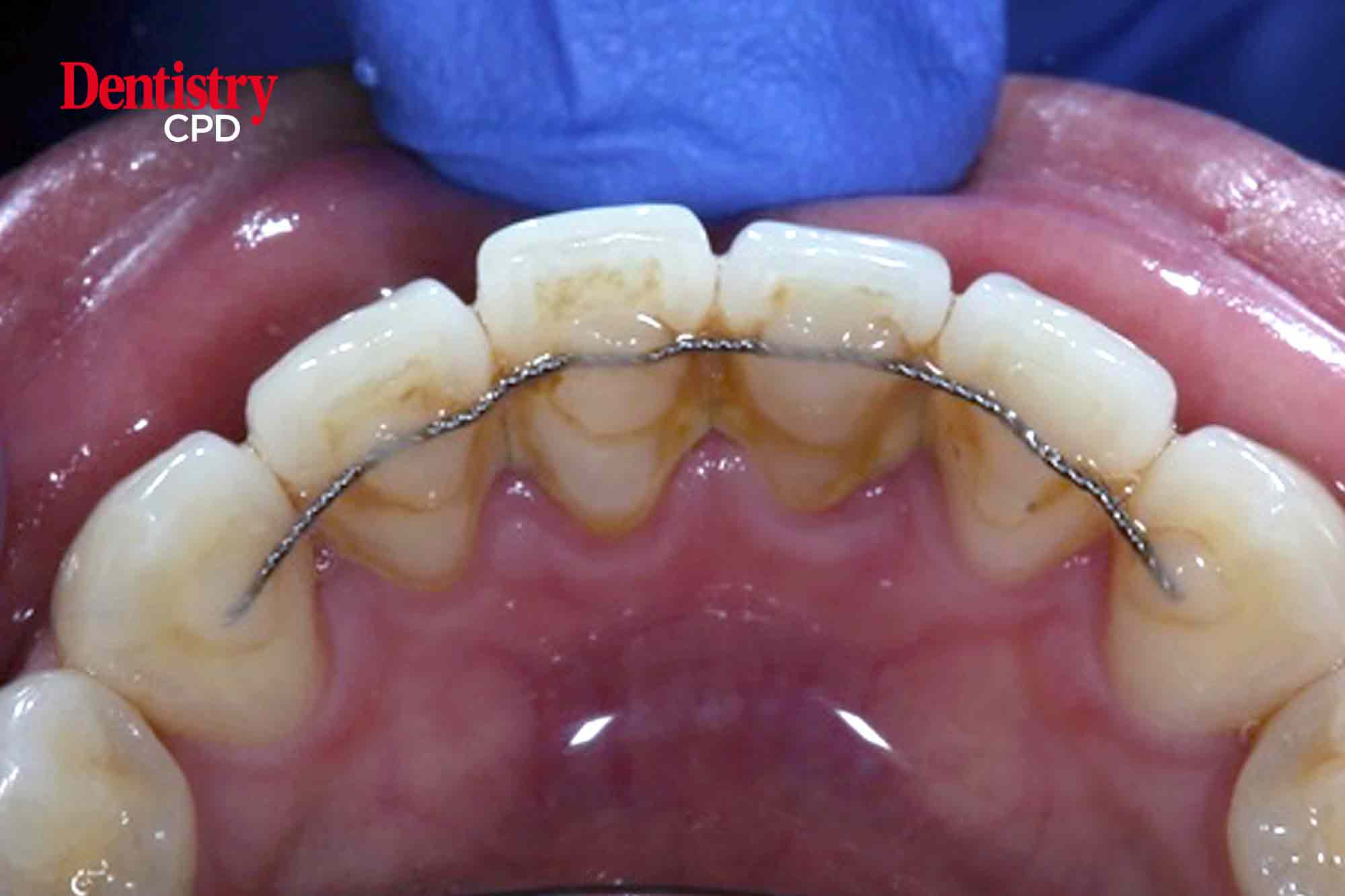 Dentistry CPD - CPD Team 2022 - Hygienist: Non-AGP management of fixed ...