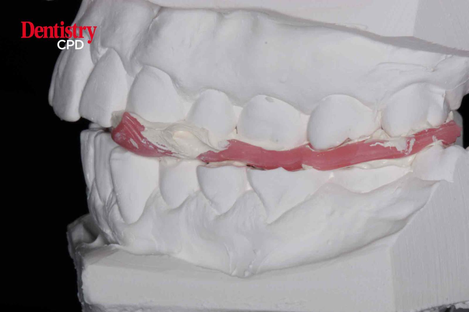 Dentistry CPD - Three steps to full mouth reconstruction - Part 1 ...