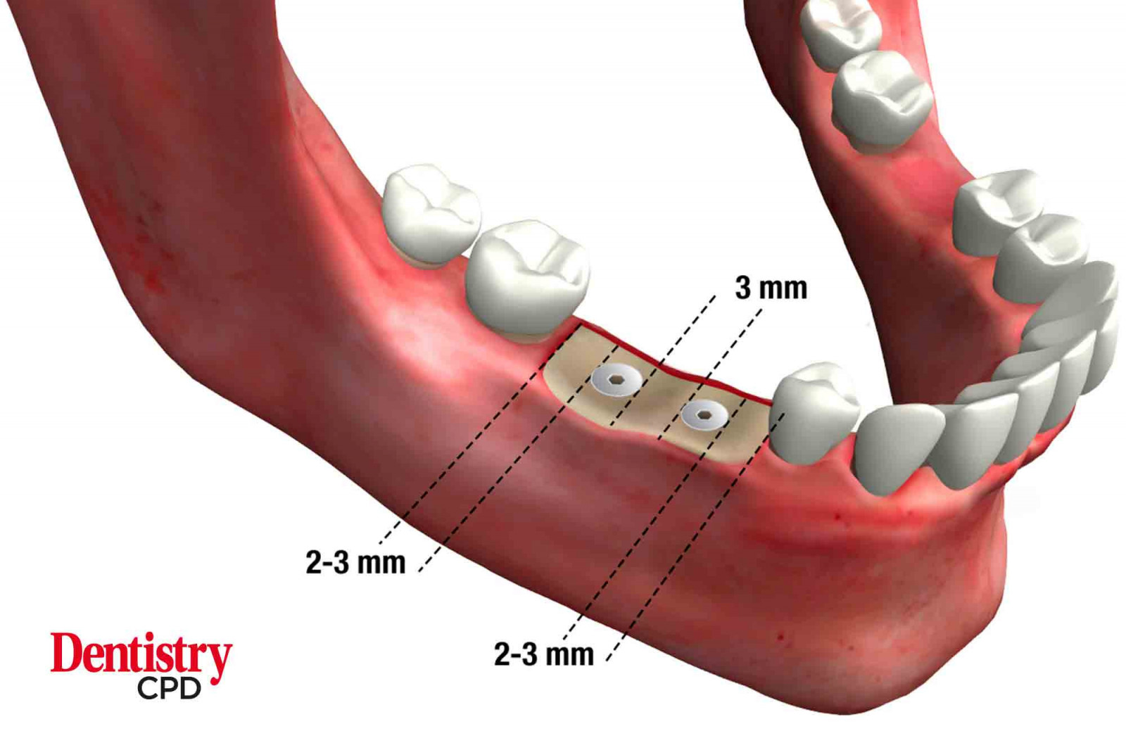 Dentistry CPD - Simplifying implant placement in the partially ...