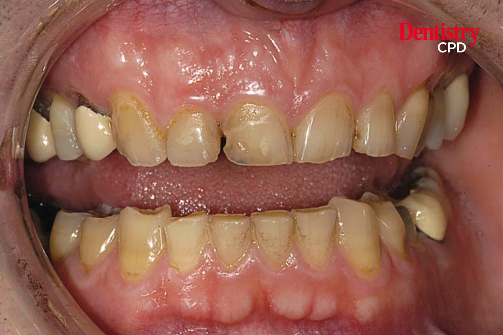 Dentistry CPD - Treating tooth wear