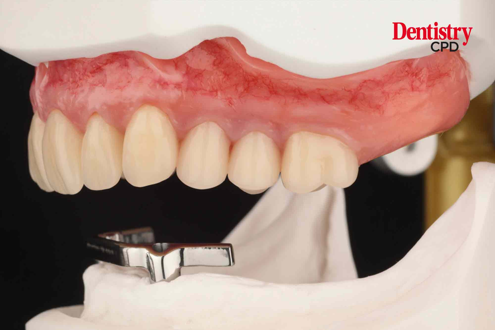 Dentistry CPD - Total prosthetics: Prefabricated teeth in individual ...