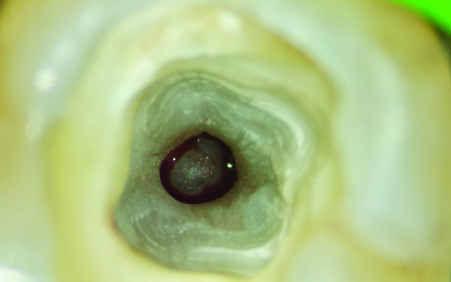 Dentistry CPD - Endodontic masterclass: C-shaped root canals