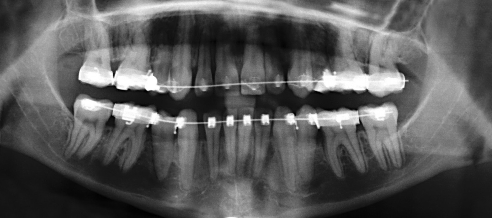 Dentistry CPD - Management of unilateral missing upper first premolar