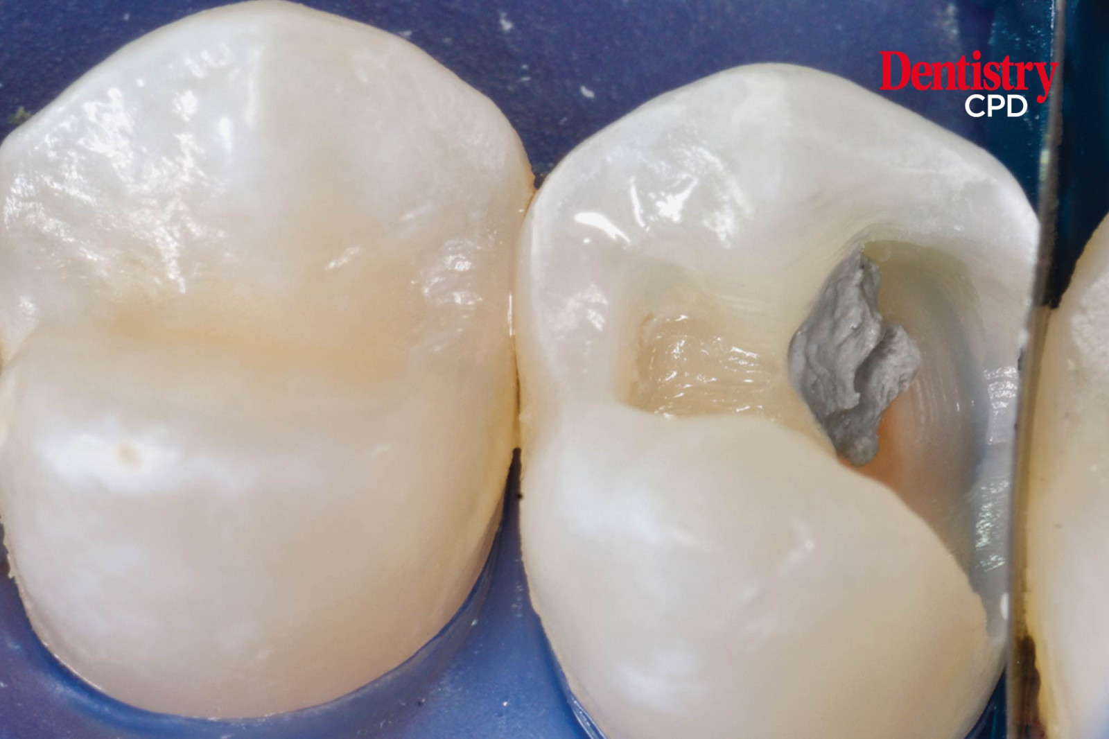 Dentistry CPD - Endodontic masterclass: direct pulp capping