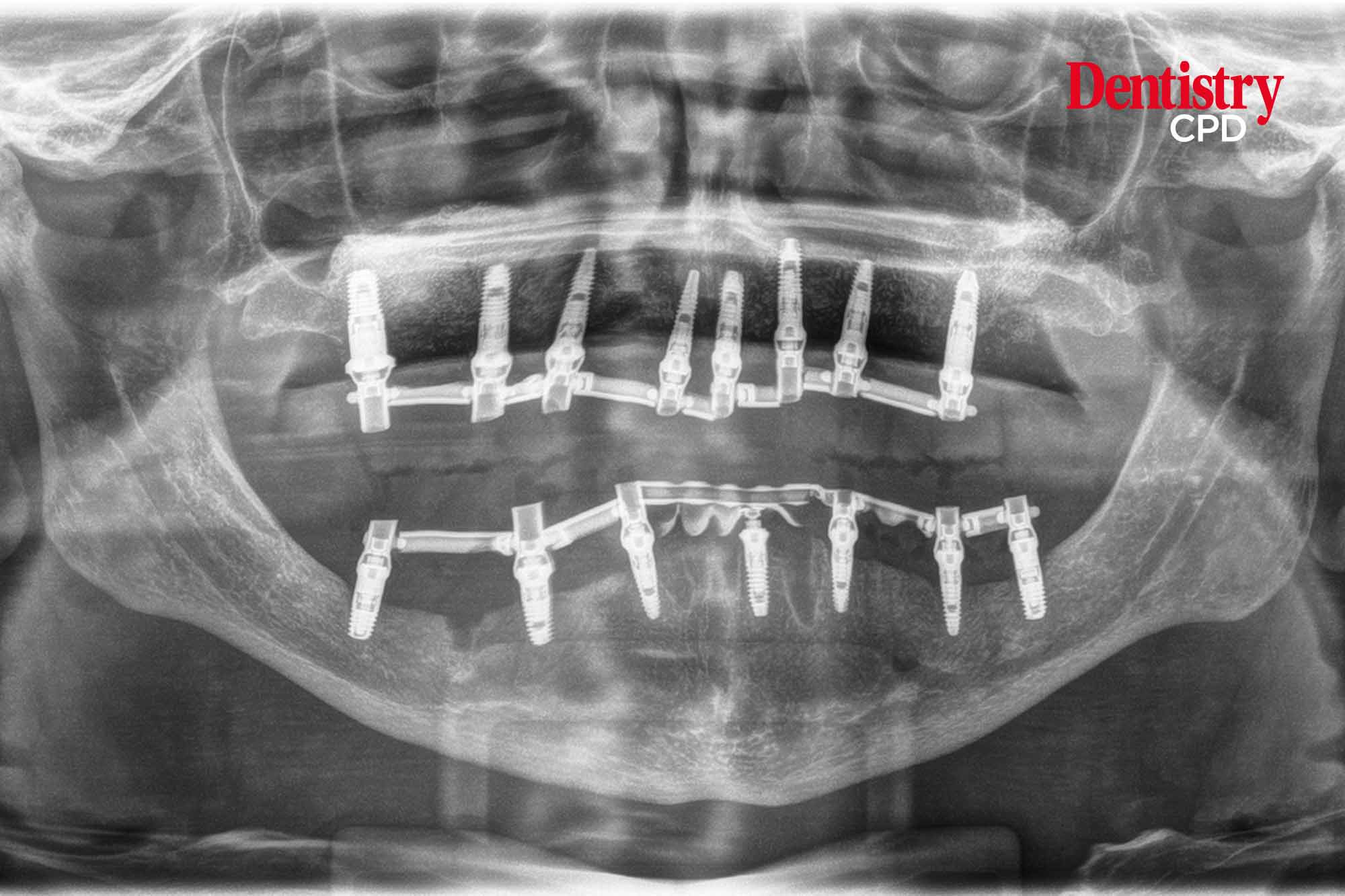 Dentistry CPD - Narrow platform implants: minimally invasive technique