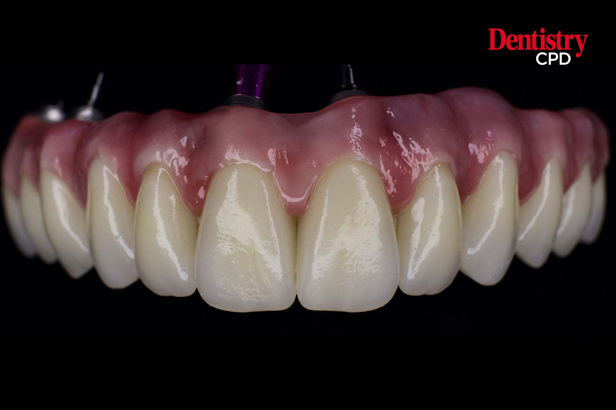 Dentistry CPD - Upper arch implant rehabilitation