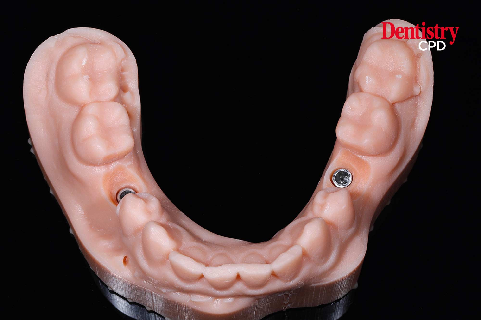 Dentistry CPD - Implant-supported restorations