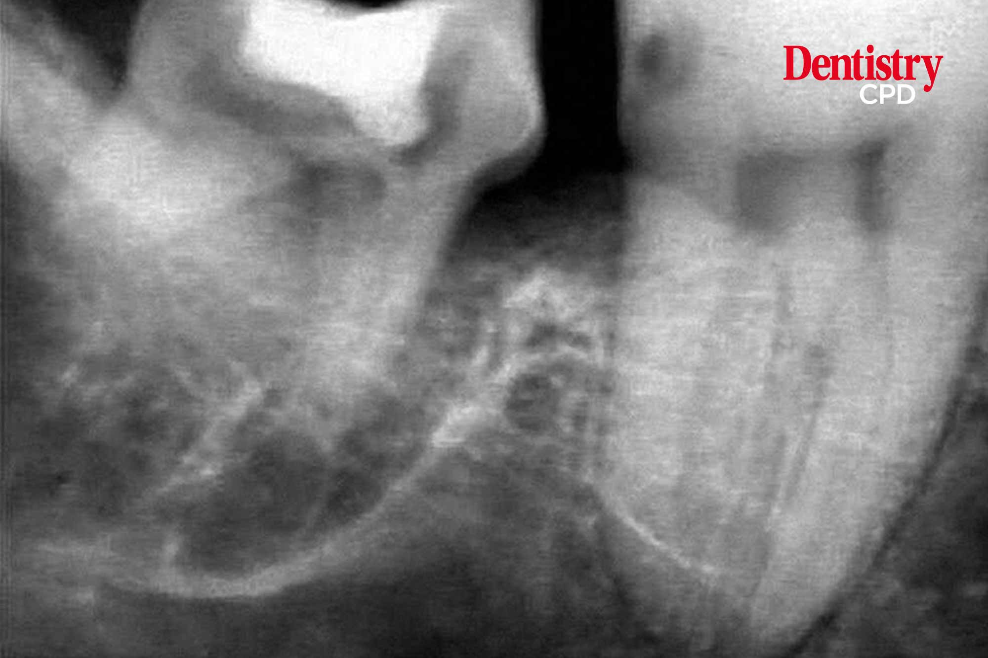 Dentistry CPD - Endodontic treatment in a rare fourth molar