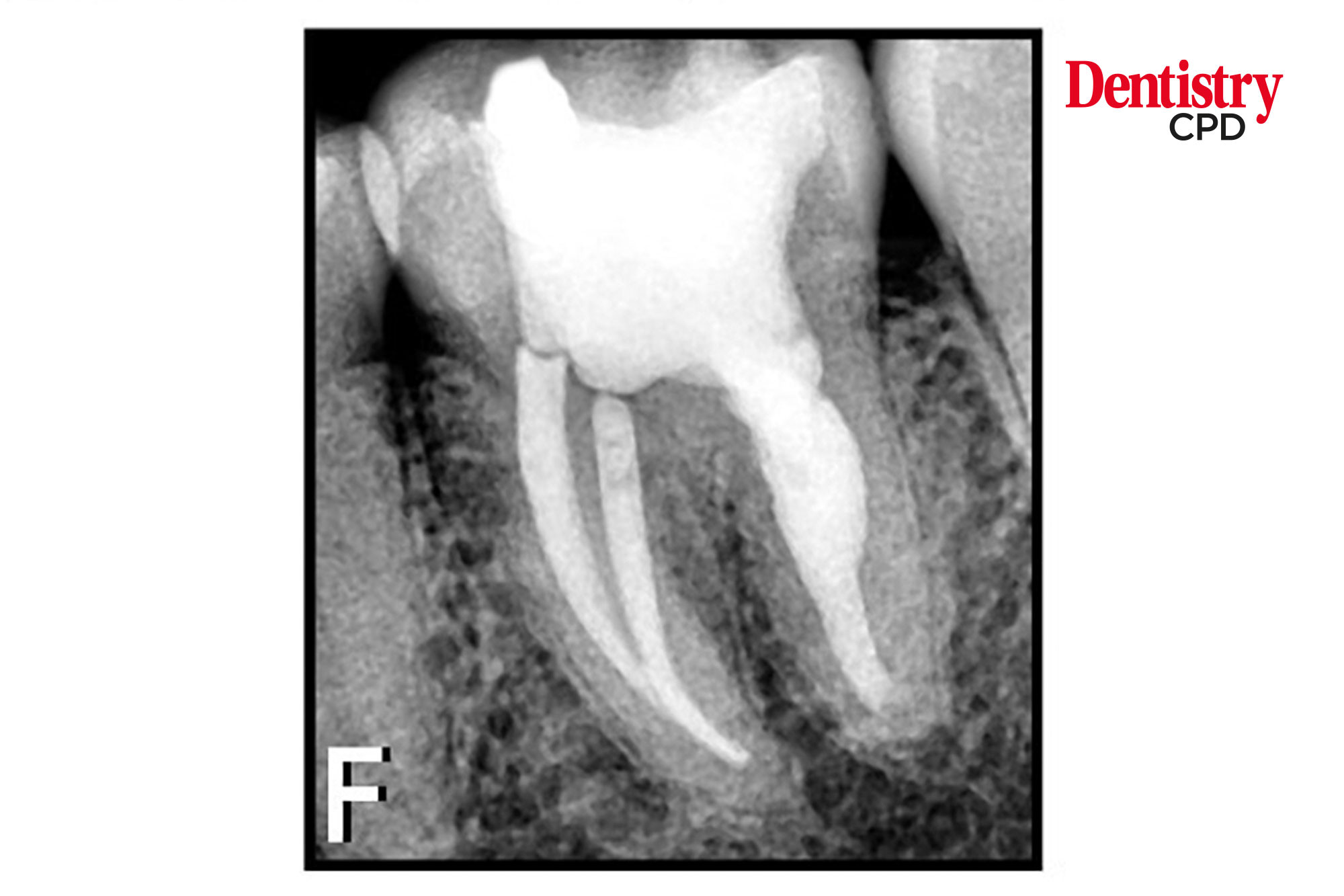 Dentistry CPD - Extensive internal root resorption