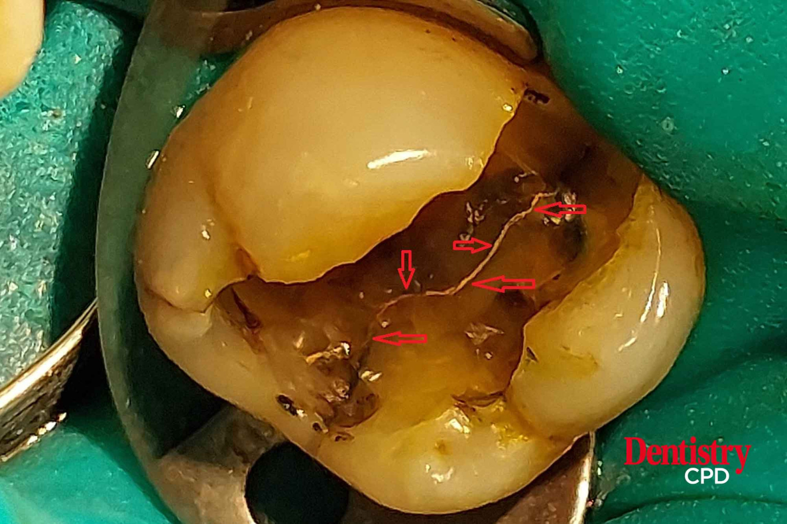 Dentistry CPD - Reveal: cracked teeth
