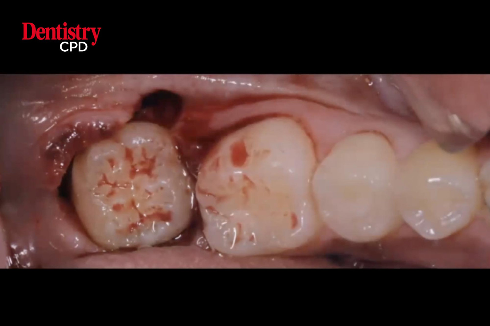 Dentistry CPD - WATCH: tooth autotransplantation