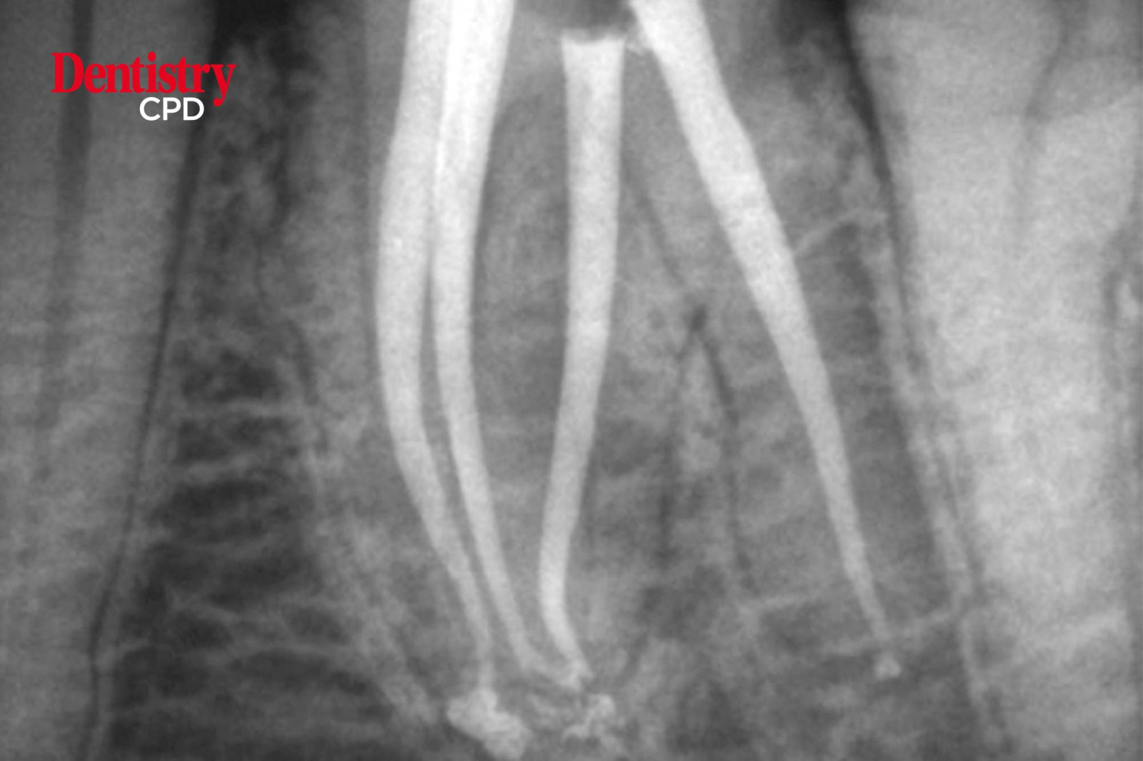 Dentistry CPD - Endodontic masterclass: radix entomolaris