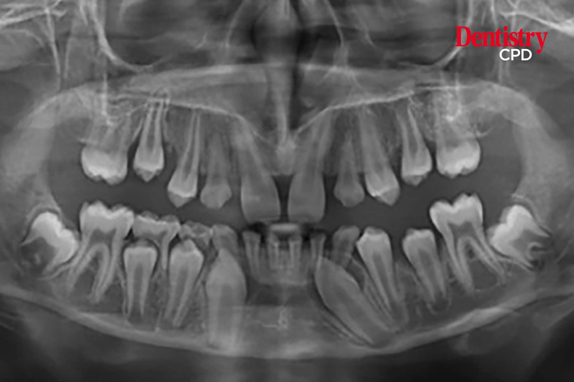 Dentistry CPD - Understanding ectopic canines