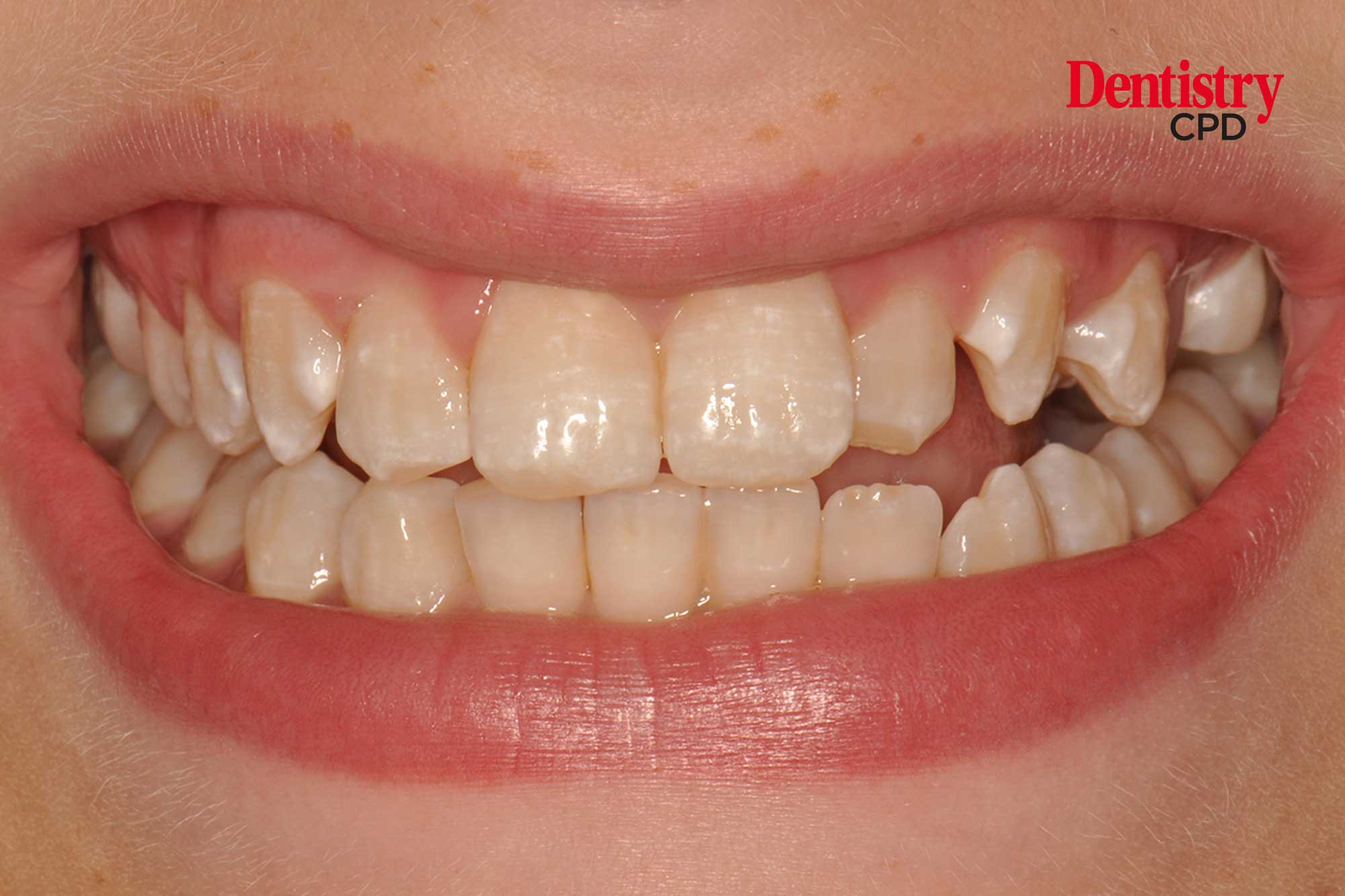 Dentistry CPD - Treating mild crossbite