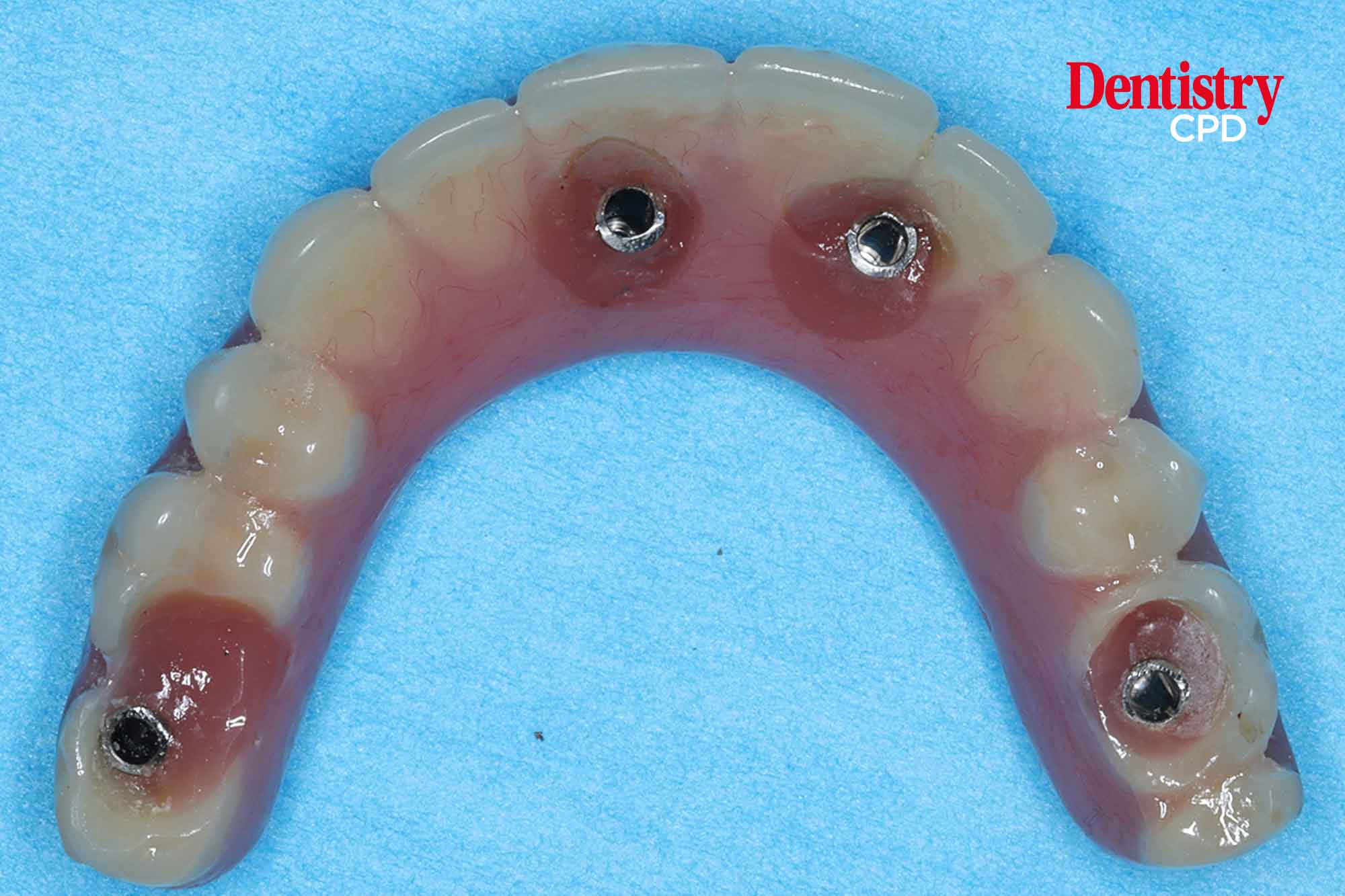 Dentistry CPD - Effective steps towards successful full arch implants