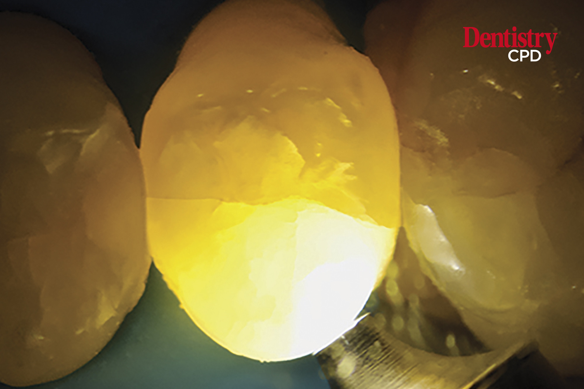 Dentistry CPD - Endodontic masterclass: structural cracks