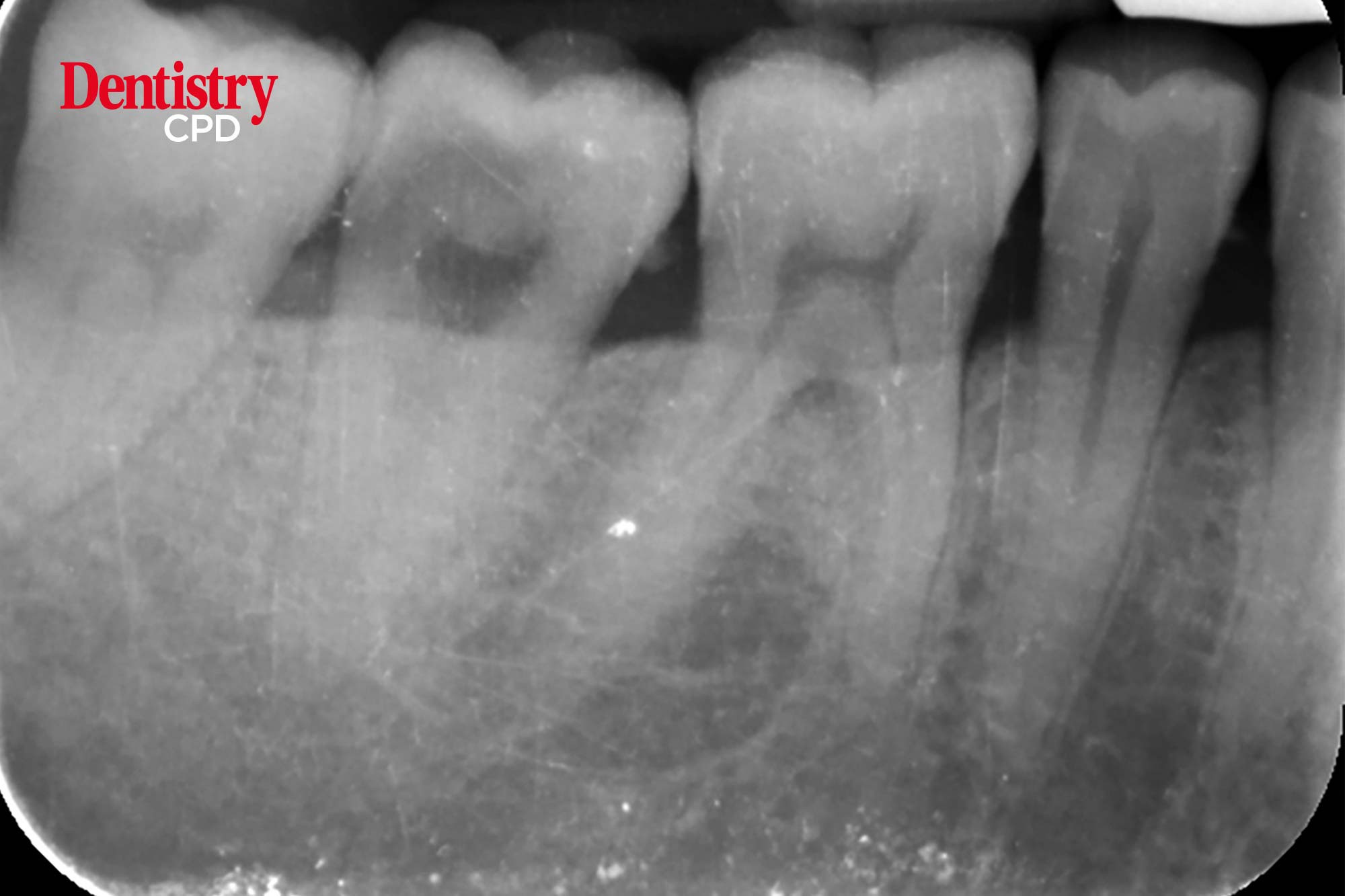 Dentistry Cpd Laser Assisted Endodontics