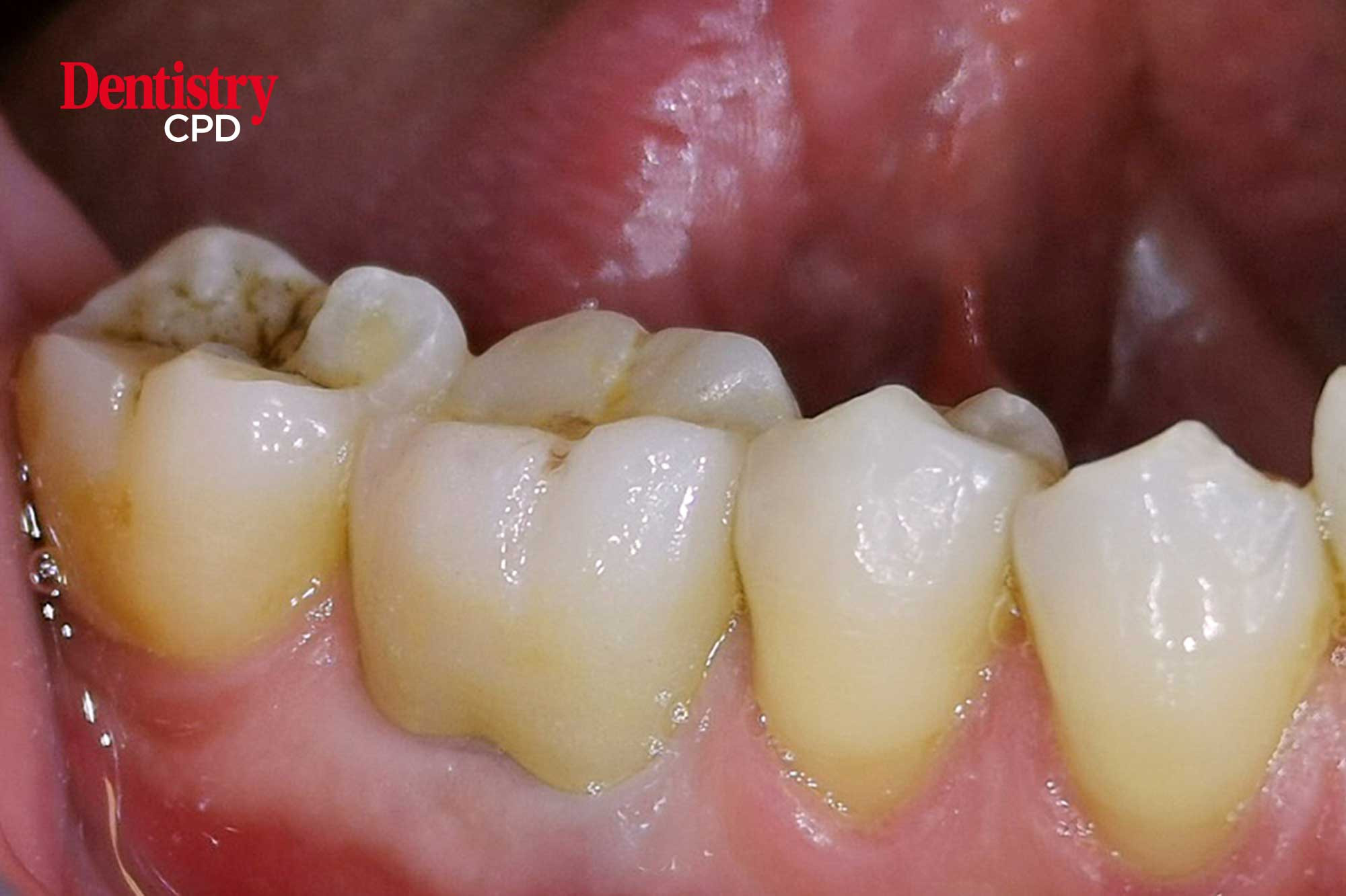 Dentistry CPD - Post-endodontic hybrid ceramic restoration