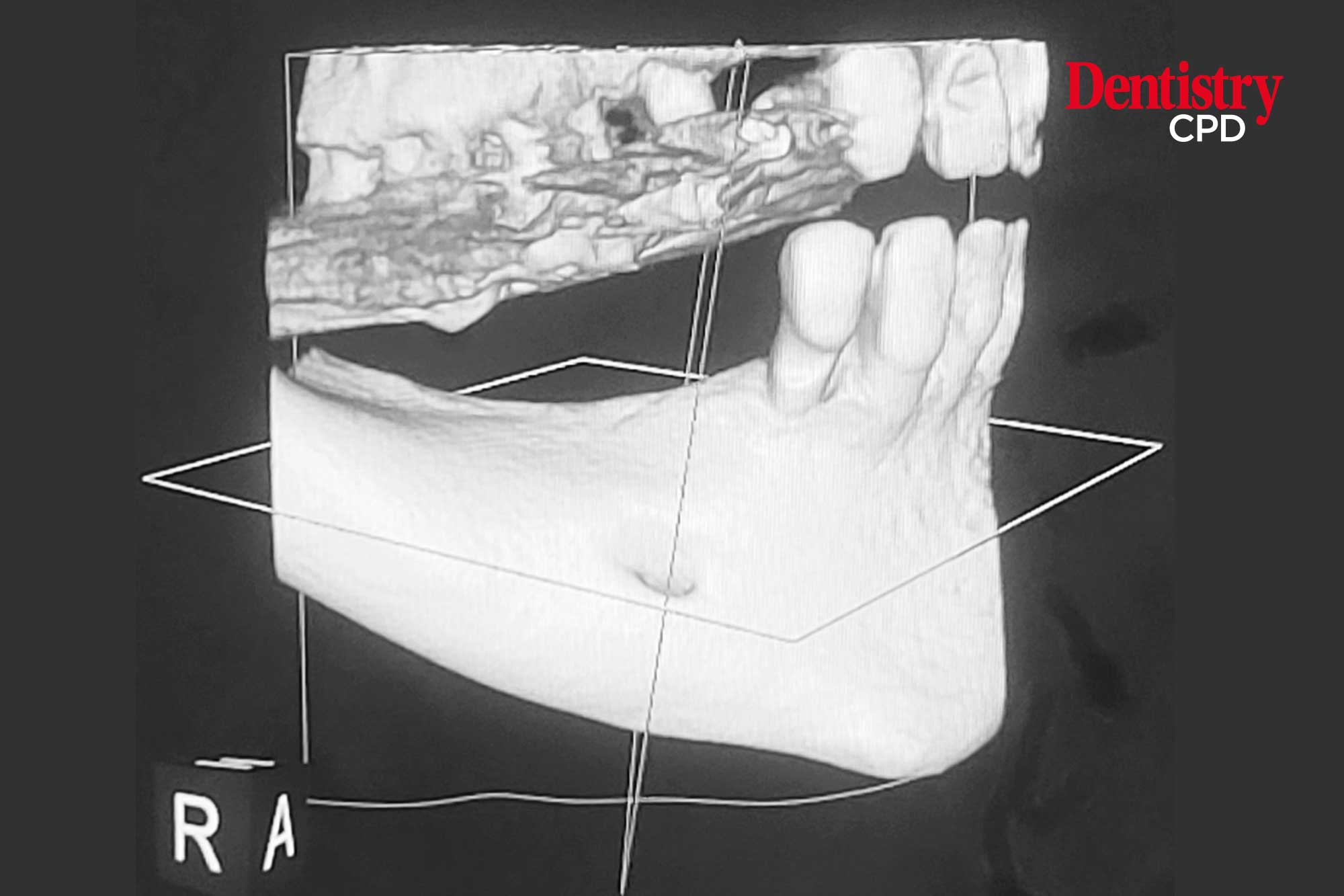 Dentistry CPD - Bone ridge split: considerations