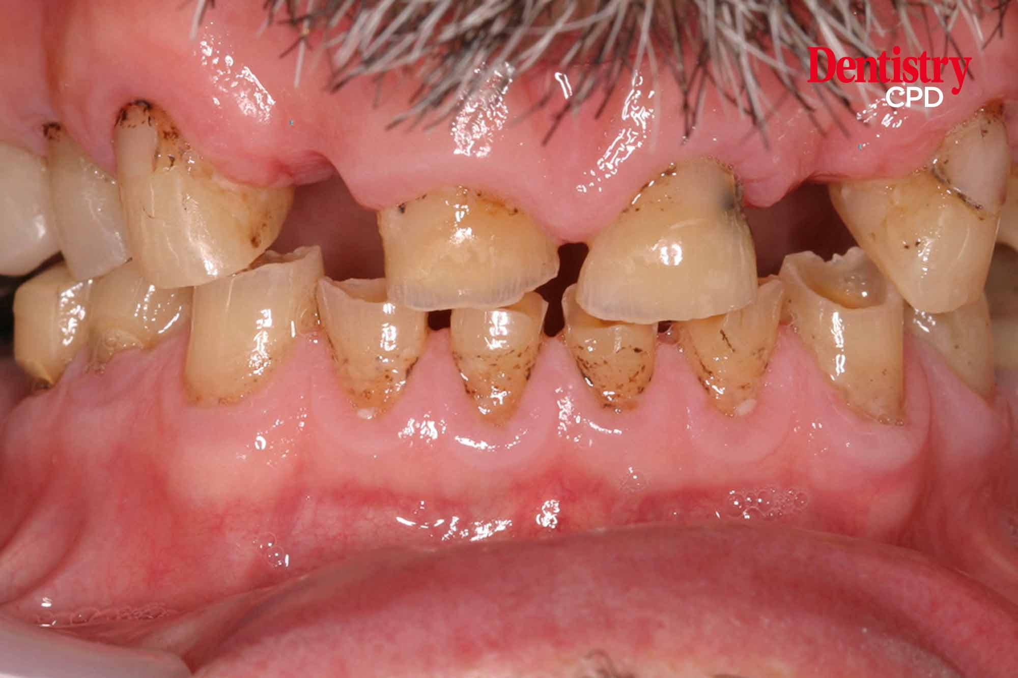 Dentistry CPD - Restoring and replacing teeth