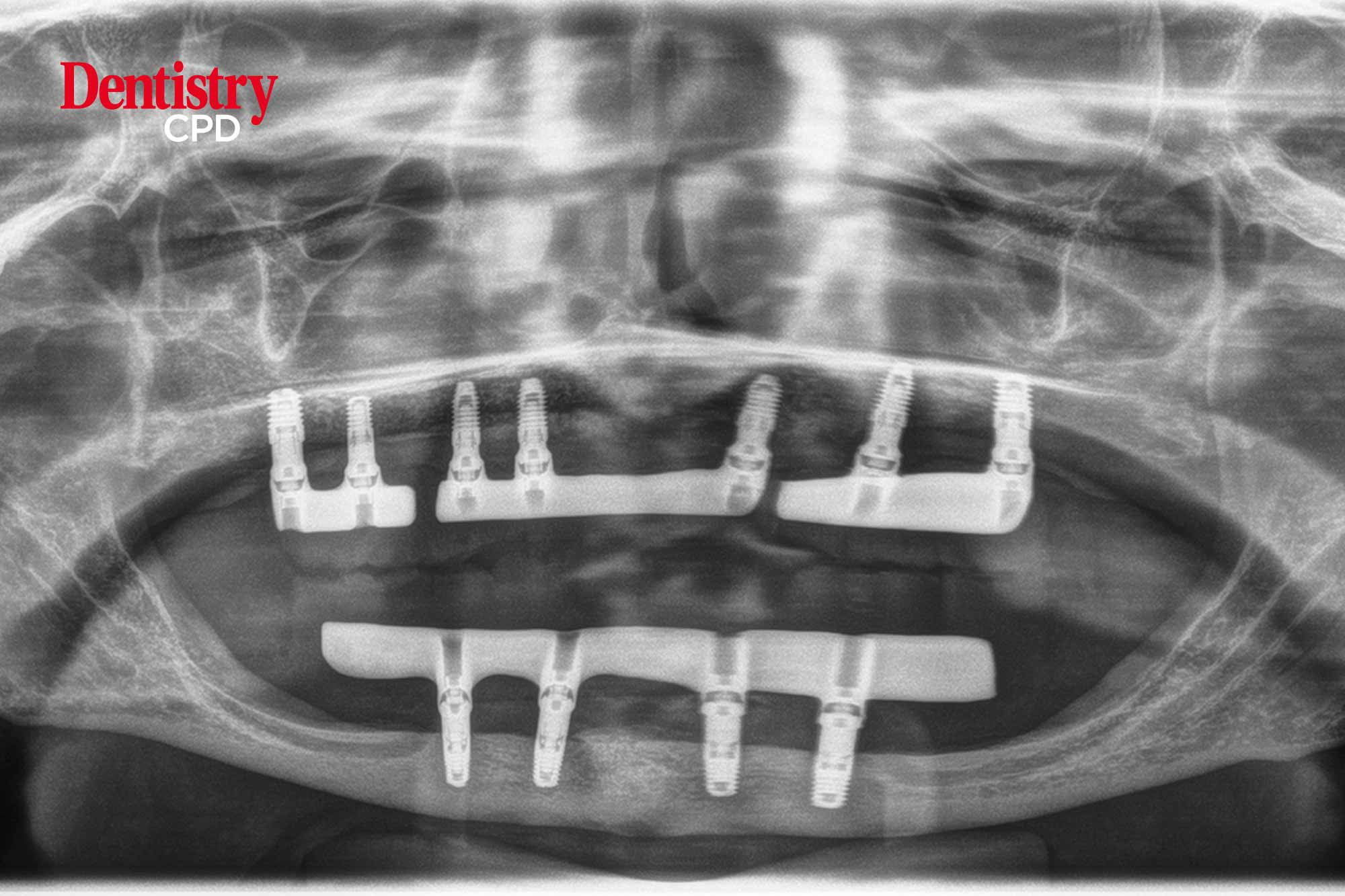 Dentistry CPD - Narrow and extra-short implants
