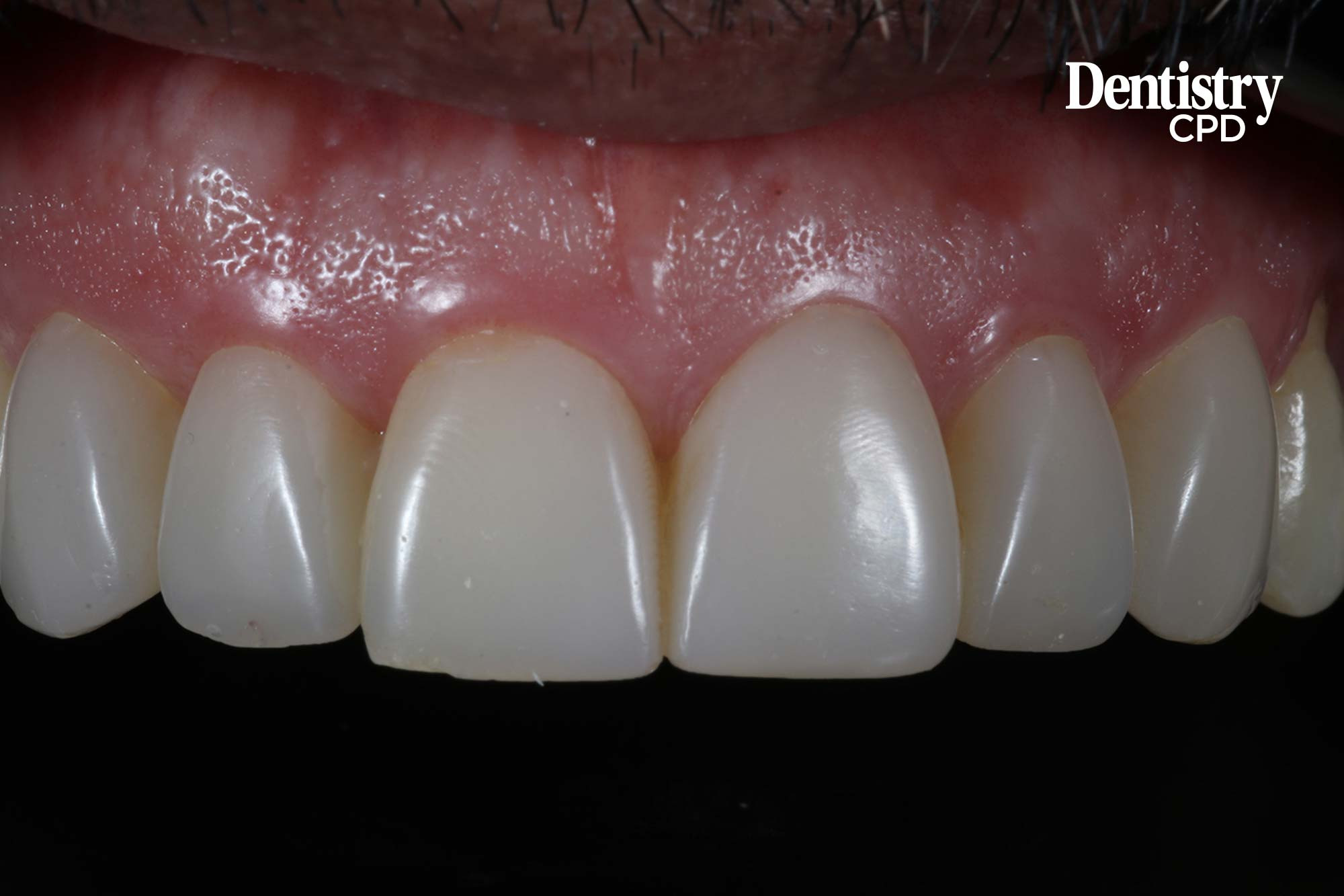 Dentistry CPD - Composite bonding: injection moulding technique Dentistry CPD - Composite bonding: injection moulding technique