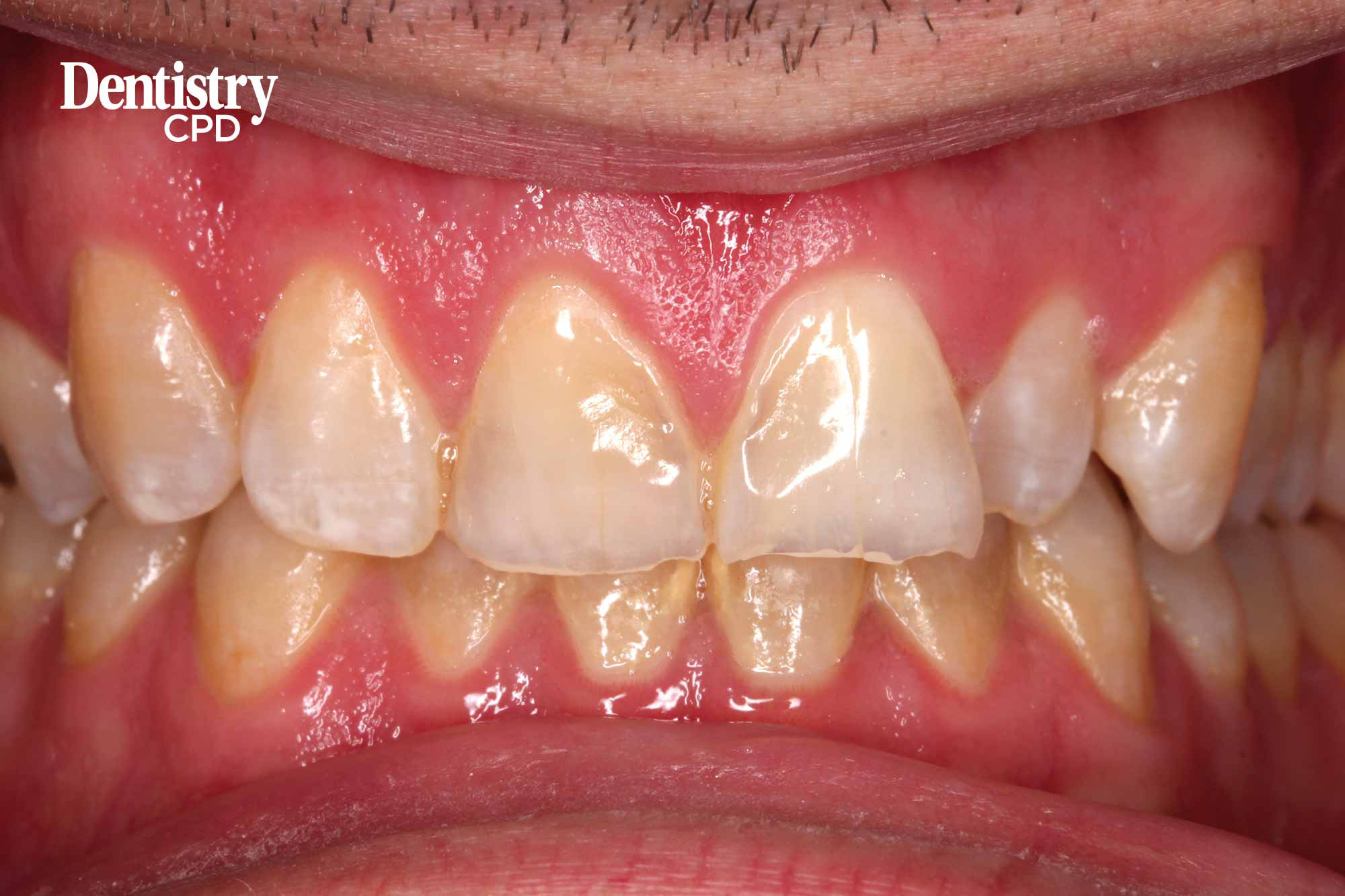 Dentistry CPD - The importance of screening for erosive tooth wear
