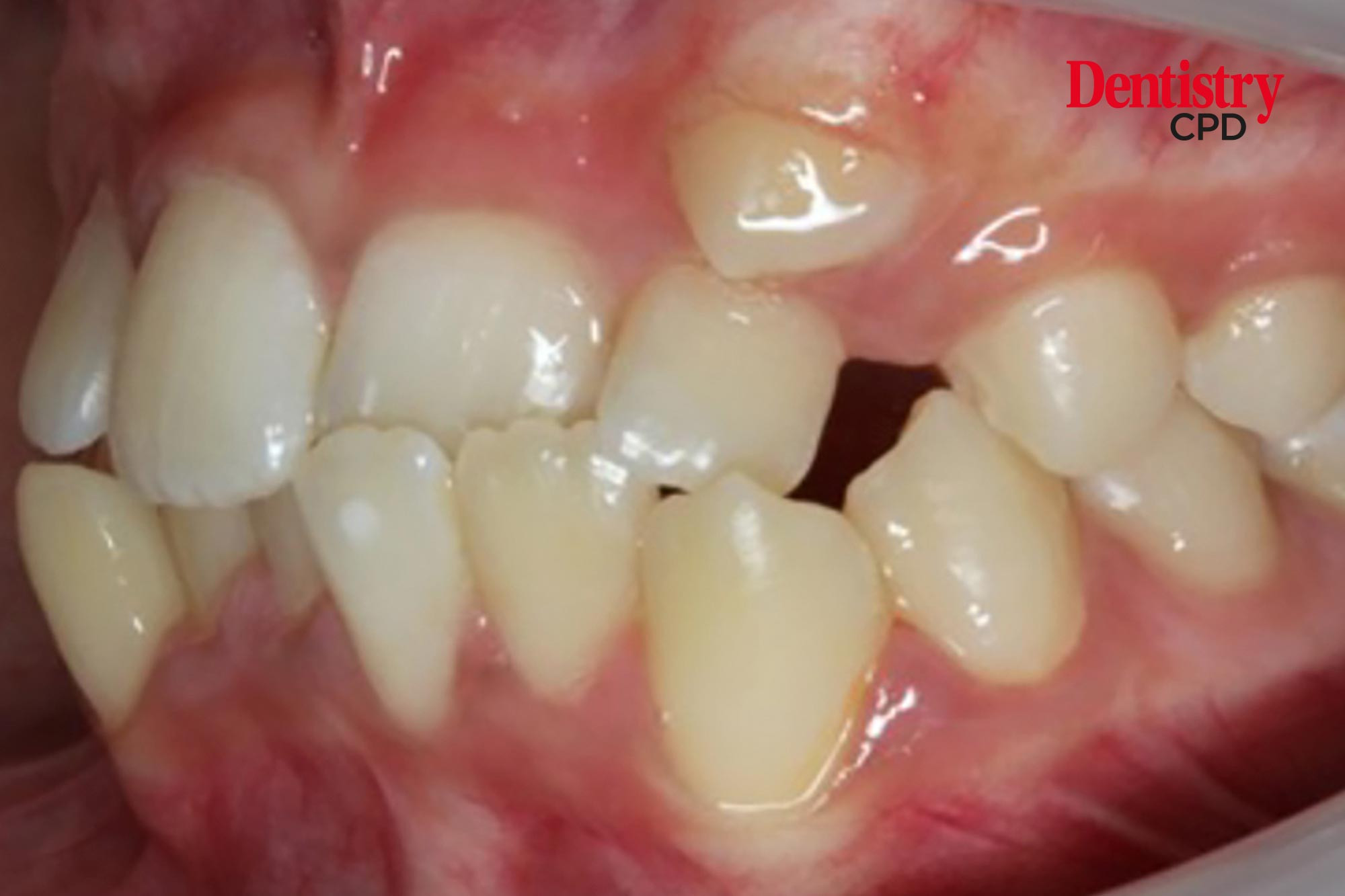 Dentistry CPD - Traumatic injuries in primary teeth