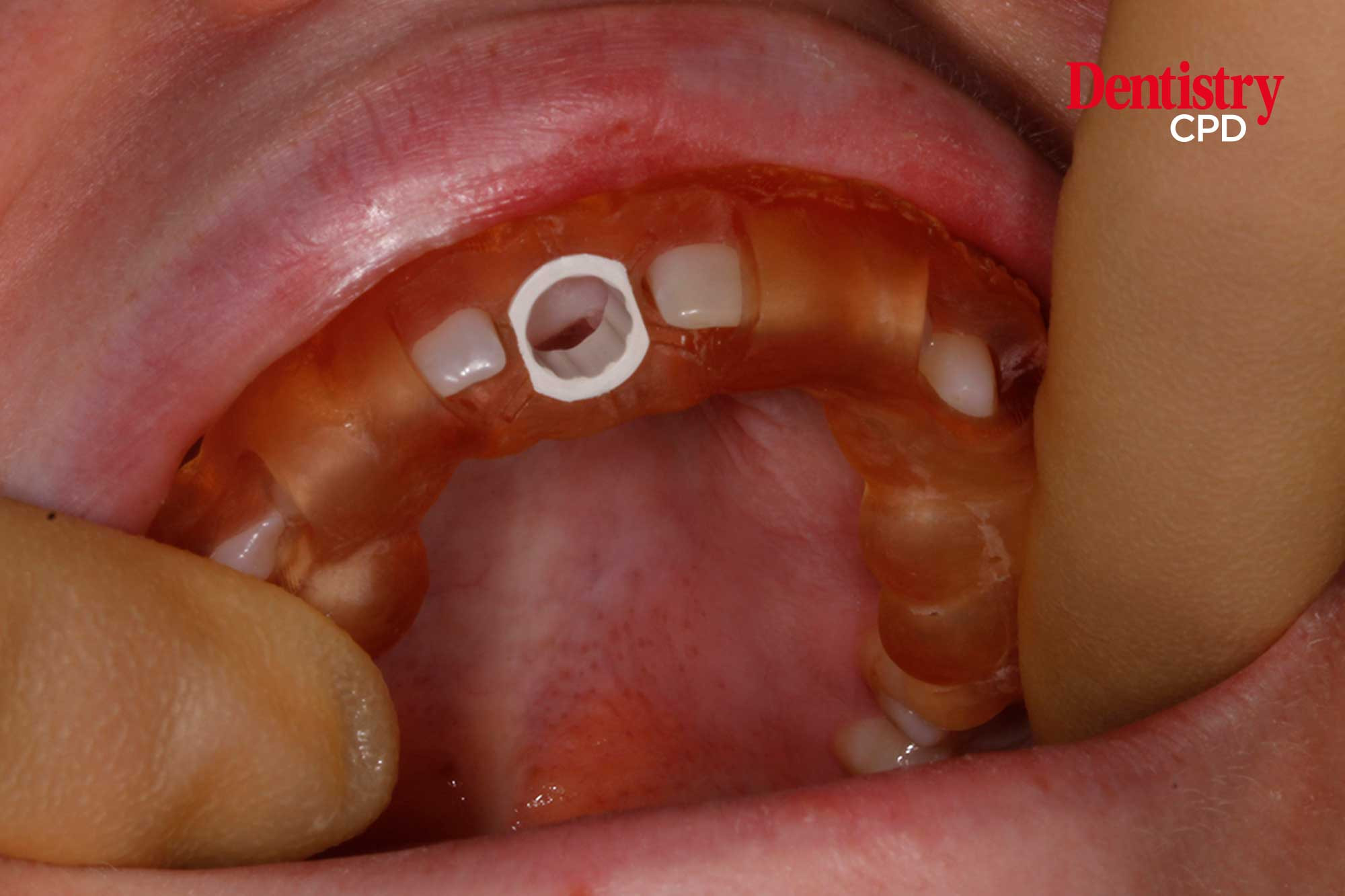 Dentistry CPD - Single tooth replacement