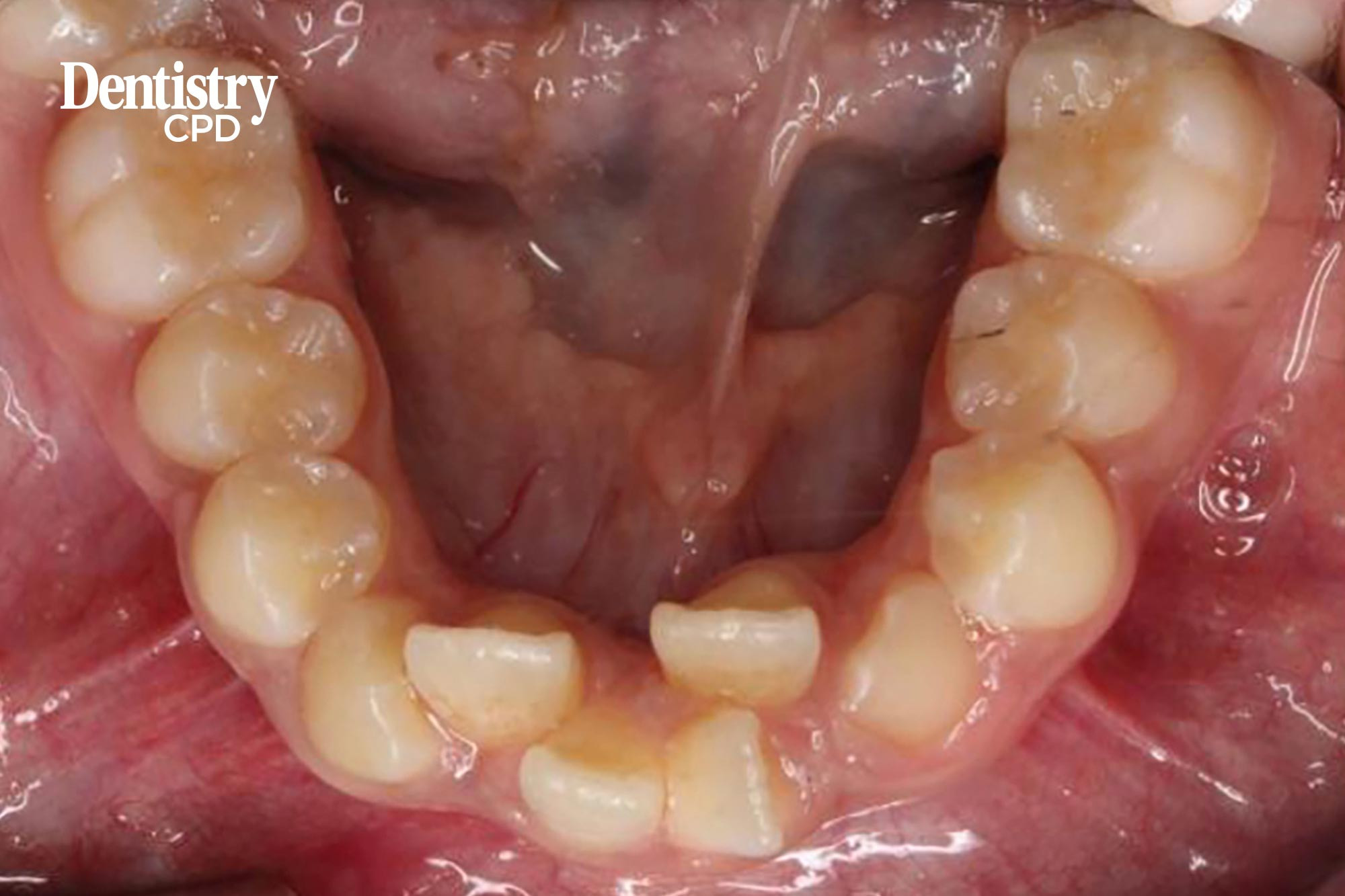 Dentistry CPD - Extraction versus non-extraction