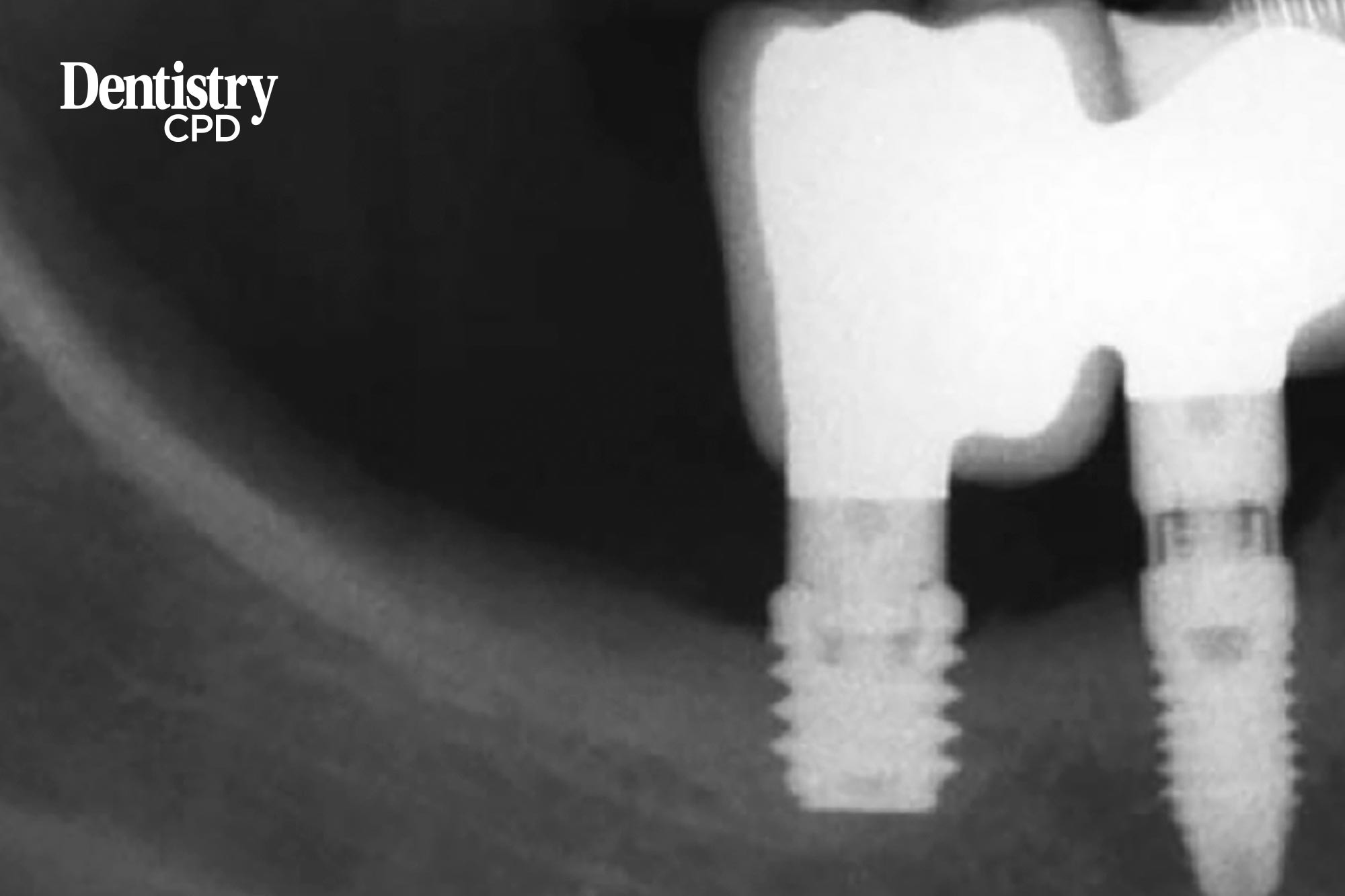 Dentistry CPD - Evaluating crown-to-implant ratio