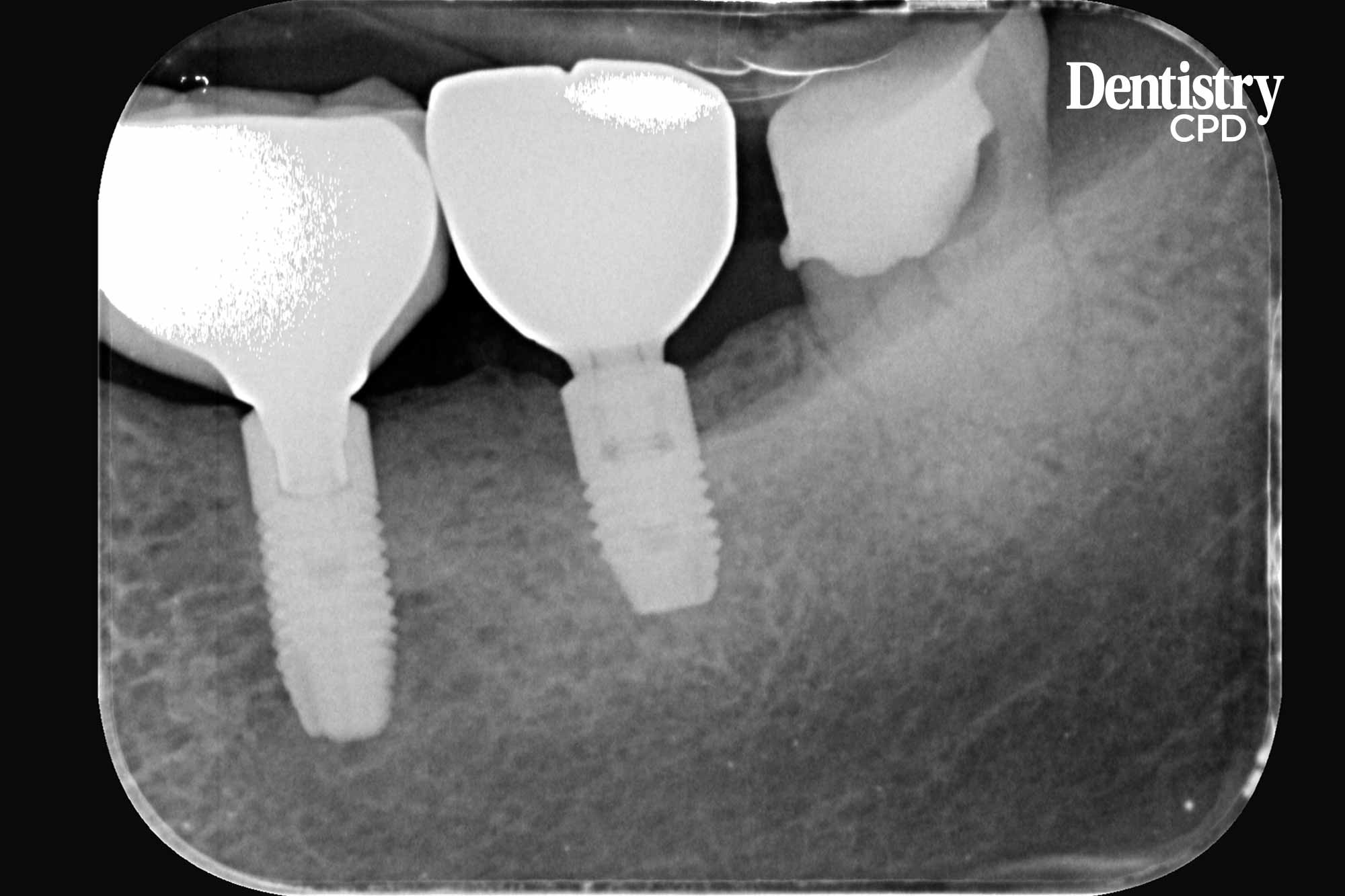 Dentistry CPD - Managing severely curved root canals