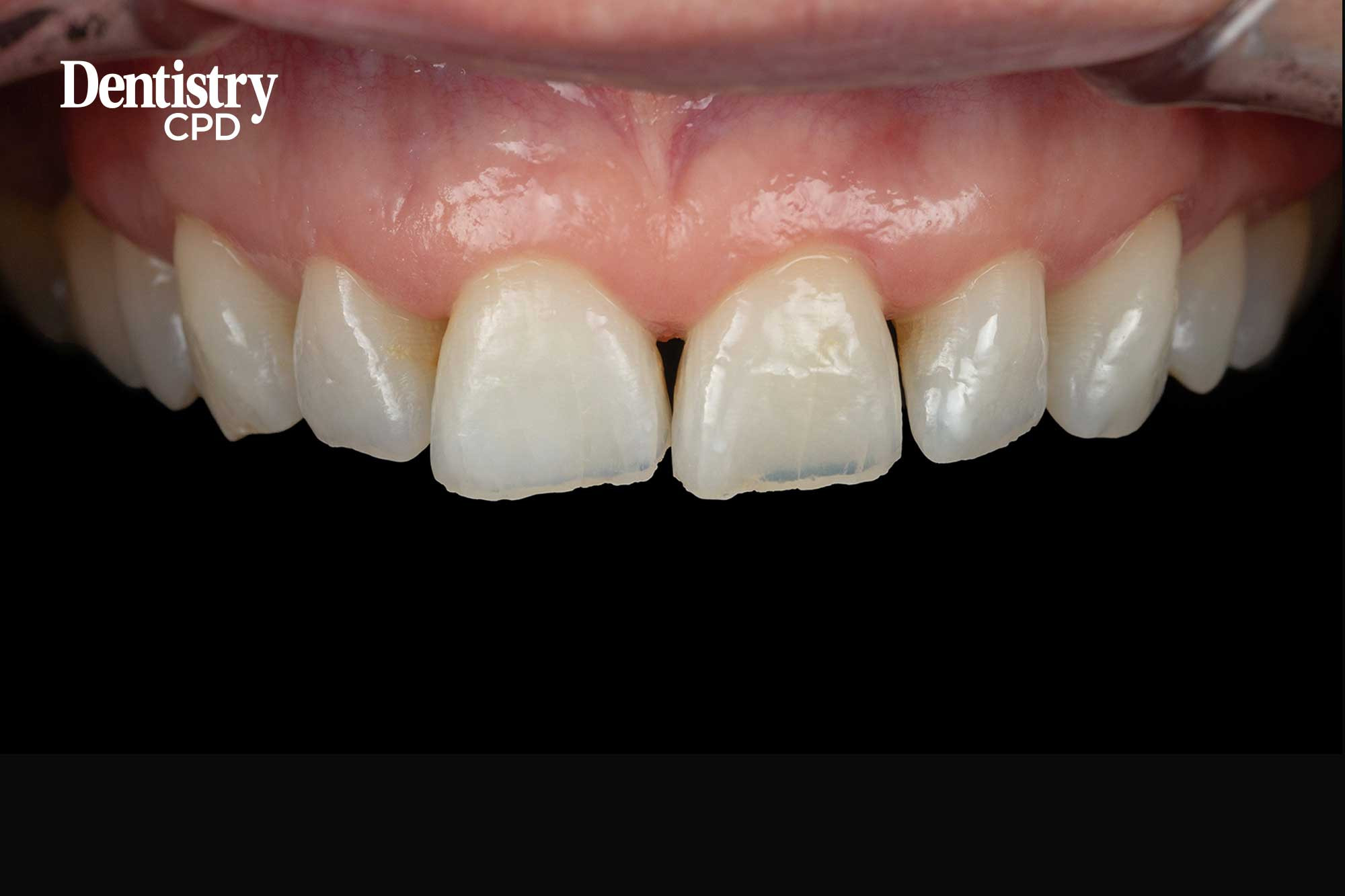 Dentistry CPD - Tooth surface loss
