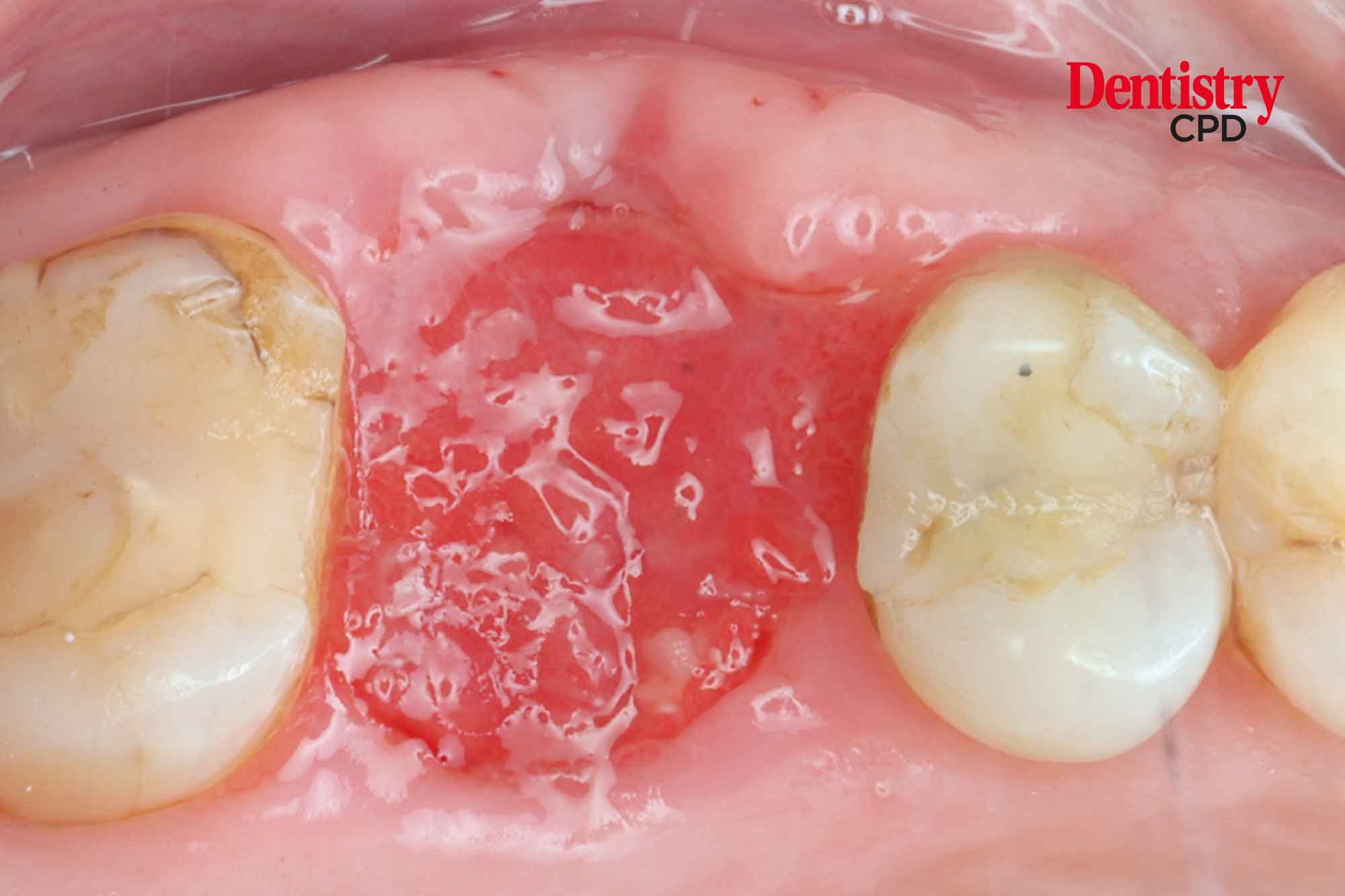 Dentistry CPD - Ridge preservation treatment