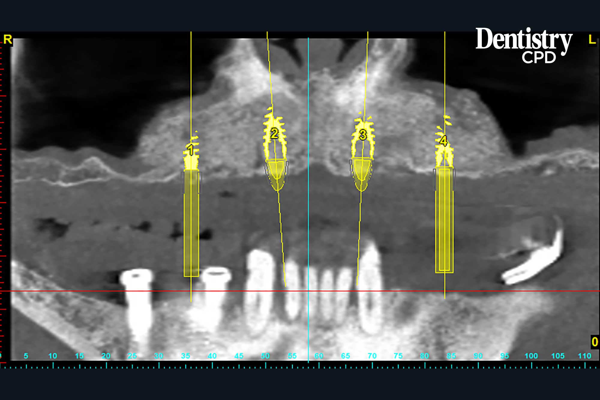 Dentistry CPD - Maxillary bilateral sinus lifts