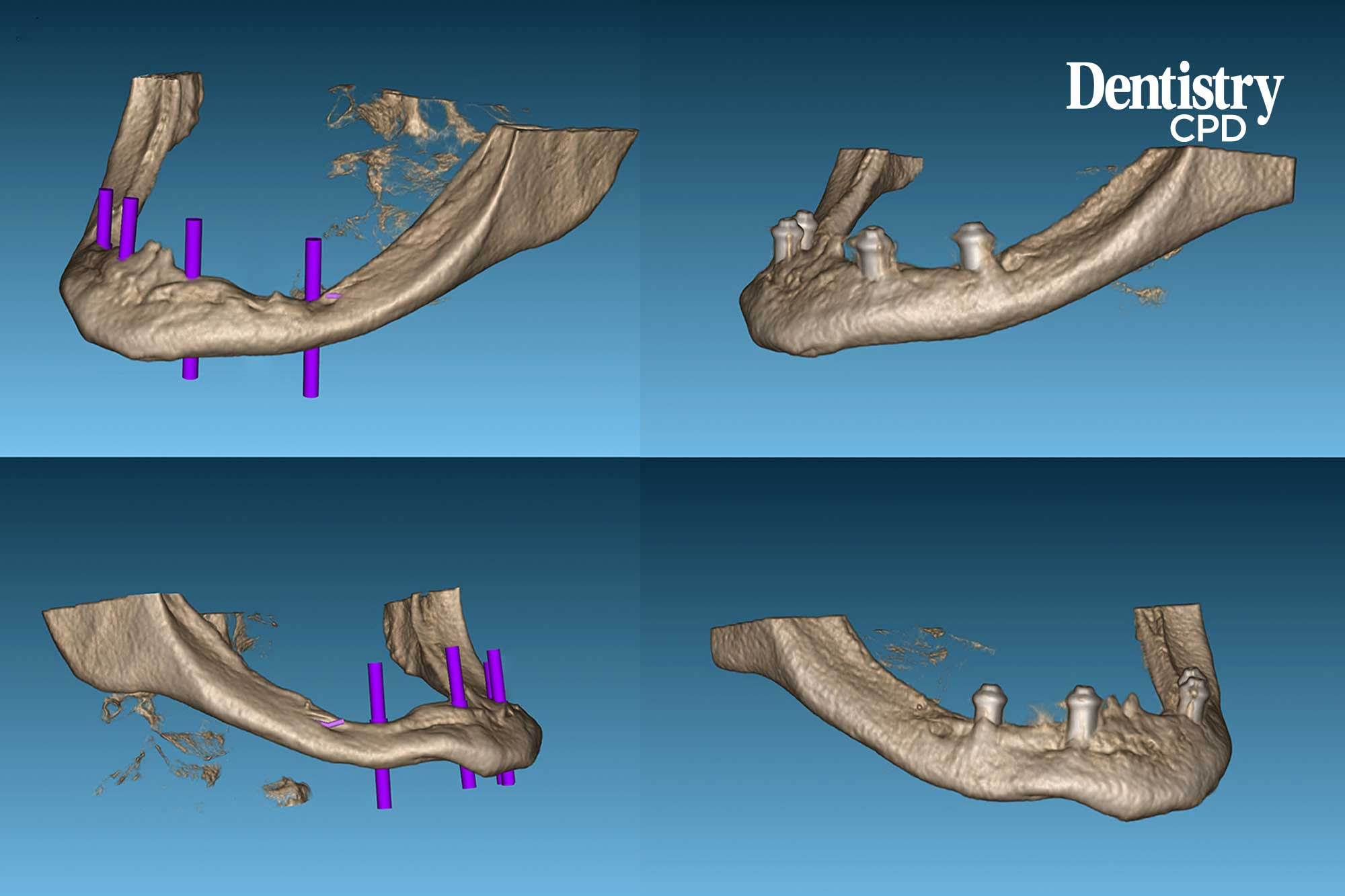 Dentistry CPD - Treating severe mandibular atrophy